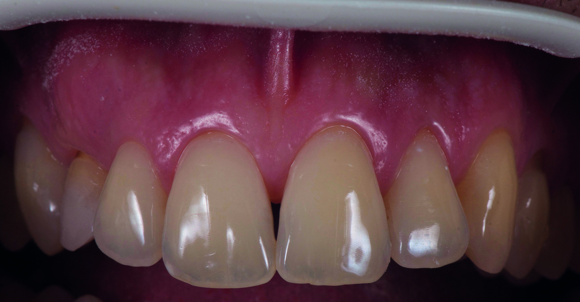 Dental News - Aesthetic Digital Smile Design: 2-D-/3-D-assisted ...