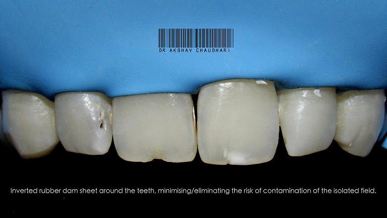 DT News - India - Rubber dam- Ace the basics