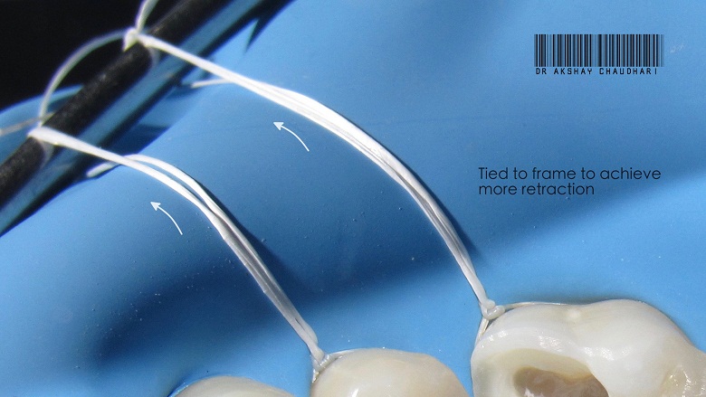 DT News - India - Rubber dam- Ace the basics