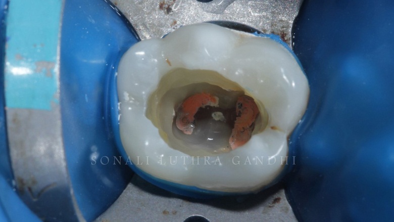 DT News - India - Cuspal layering technique to produce aesthetic ...