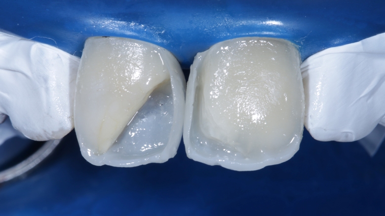 Bringing anterior direct composite restorations to life with histologic ...
