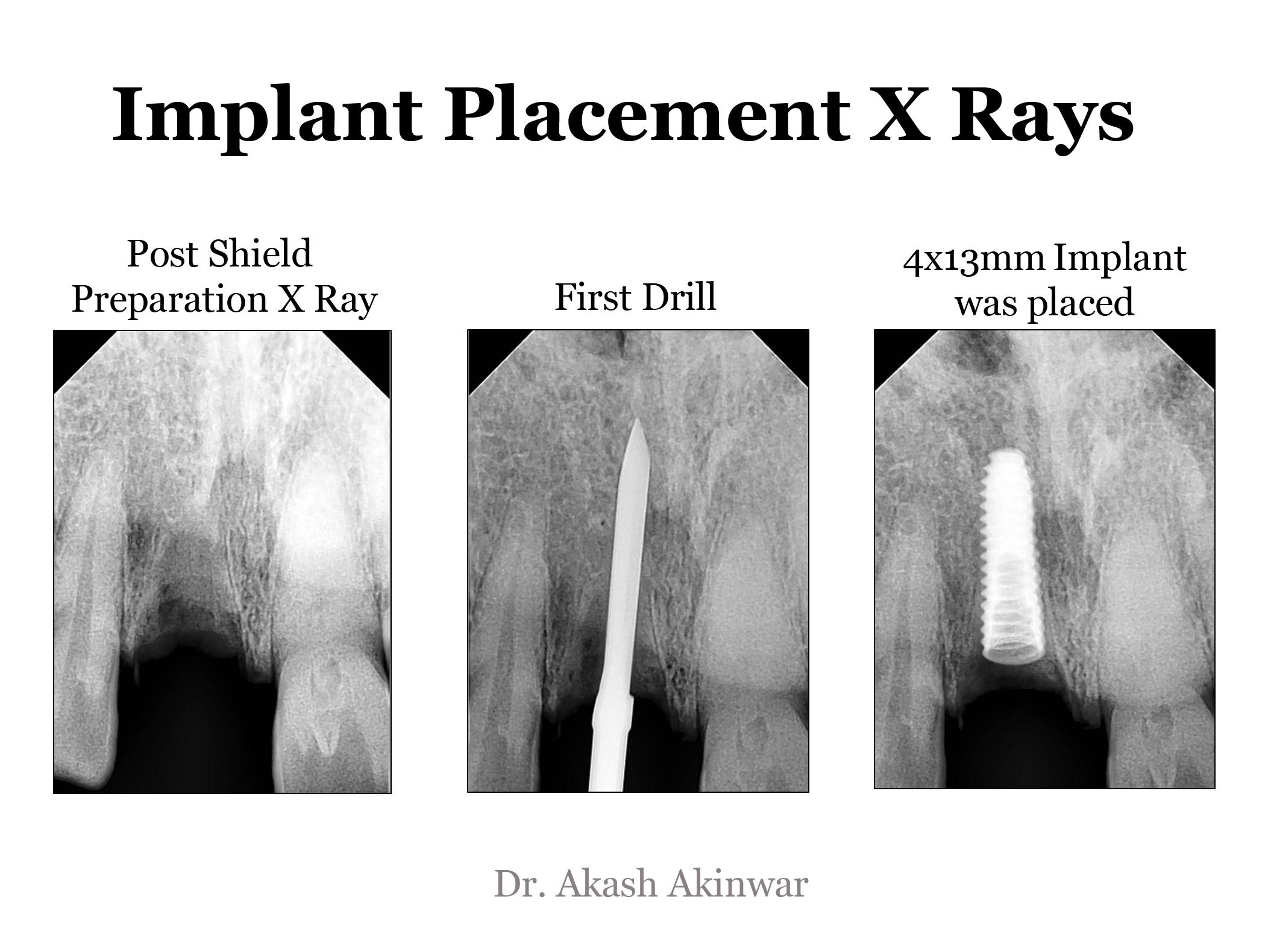 Immediate Implant Placement with Socket Shield Technique followed by ...