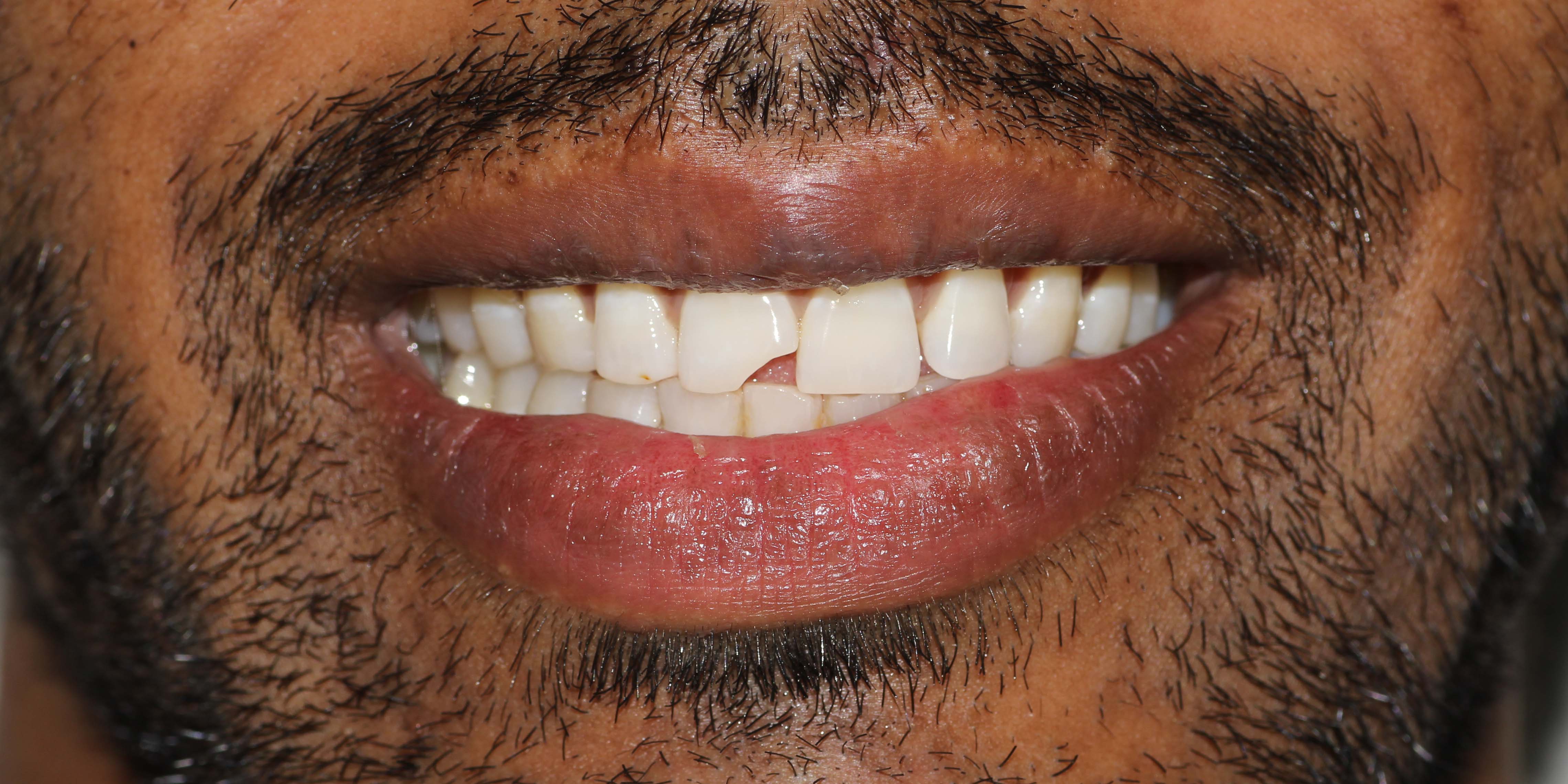 DT News - India - Developing tight proximal contacts in anterior teeth ...