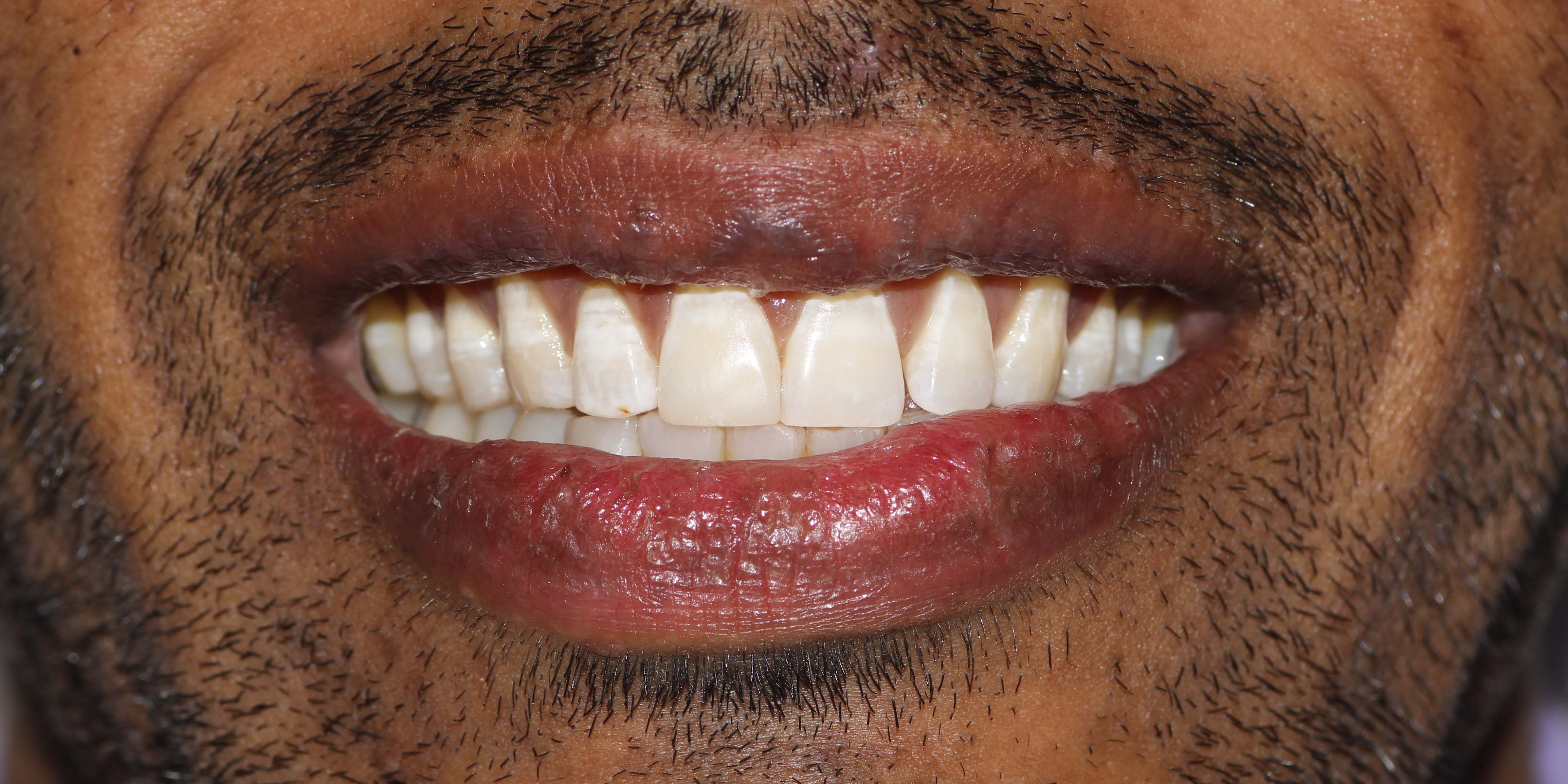 Developing tight proximal contacts in anterior teeth using Unica ...