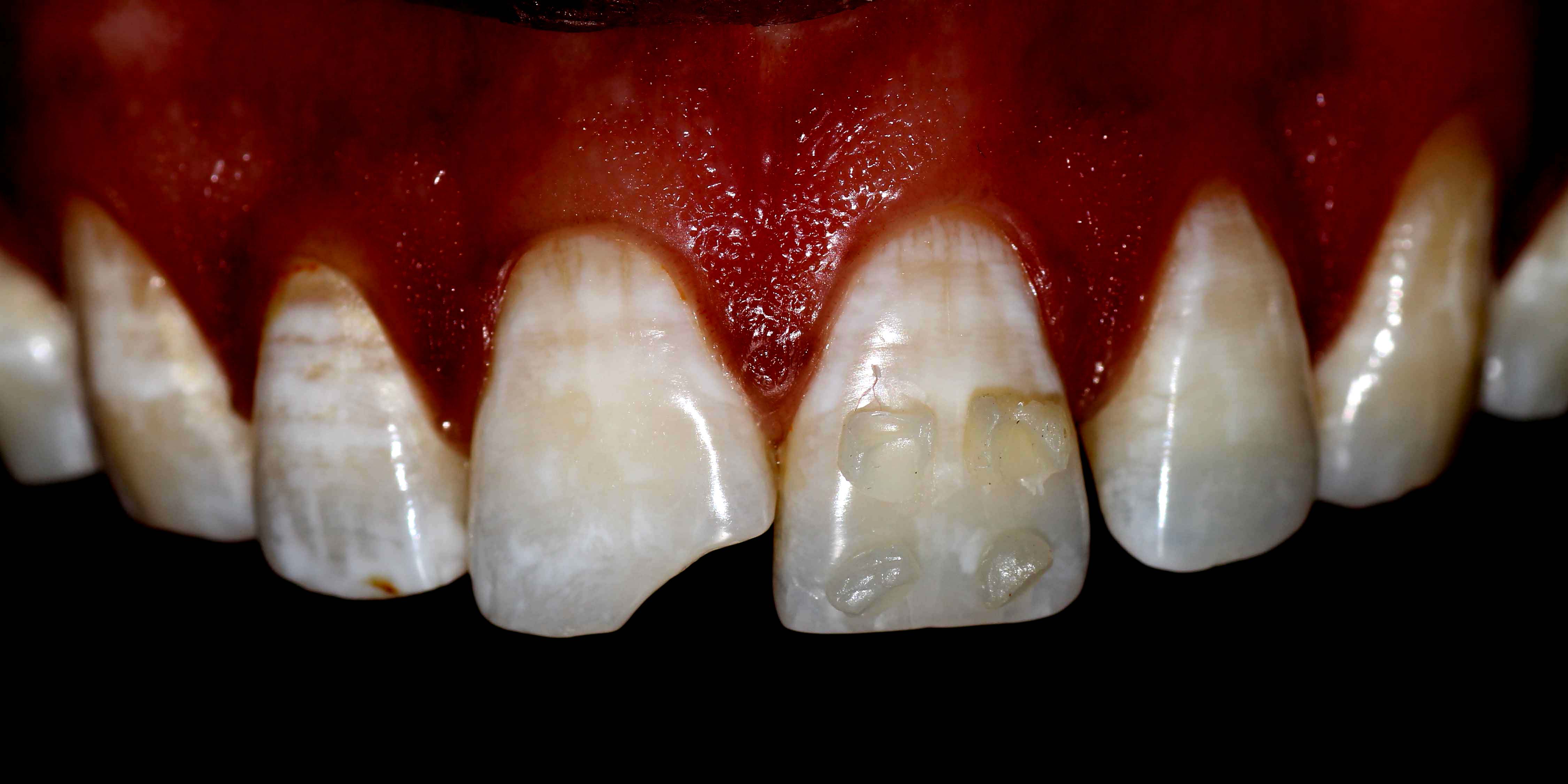 DT News - India - Developing tight proximal contacts in anterior teeth ...