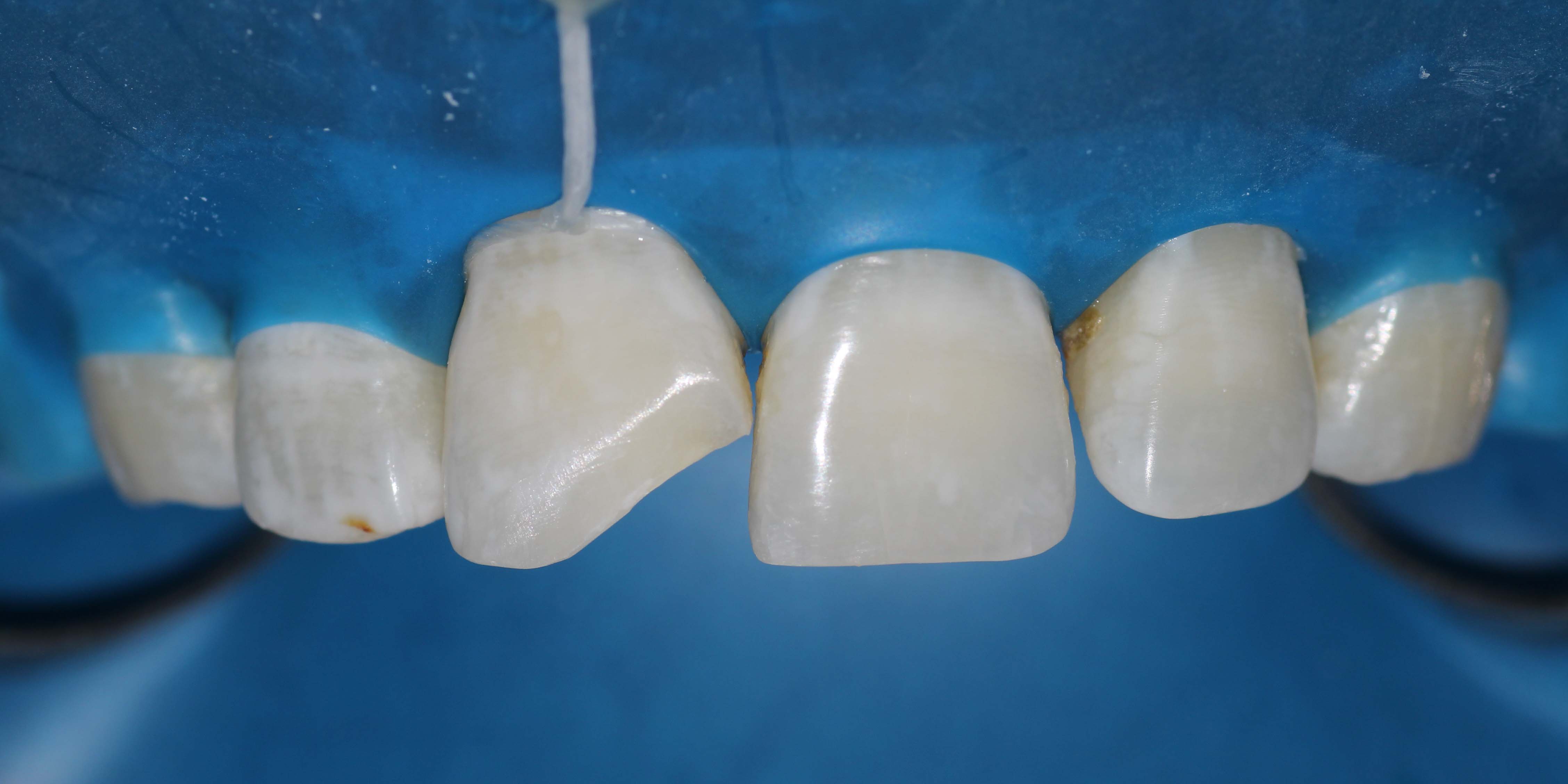 DT News - India - Developing tight proximal contacts in anterior teeth ...