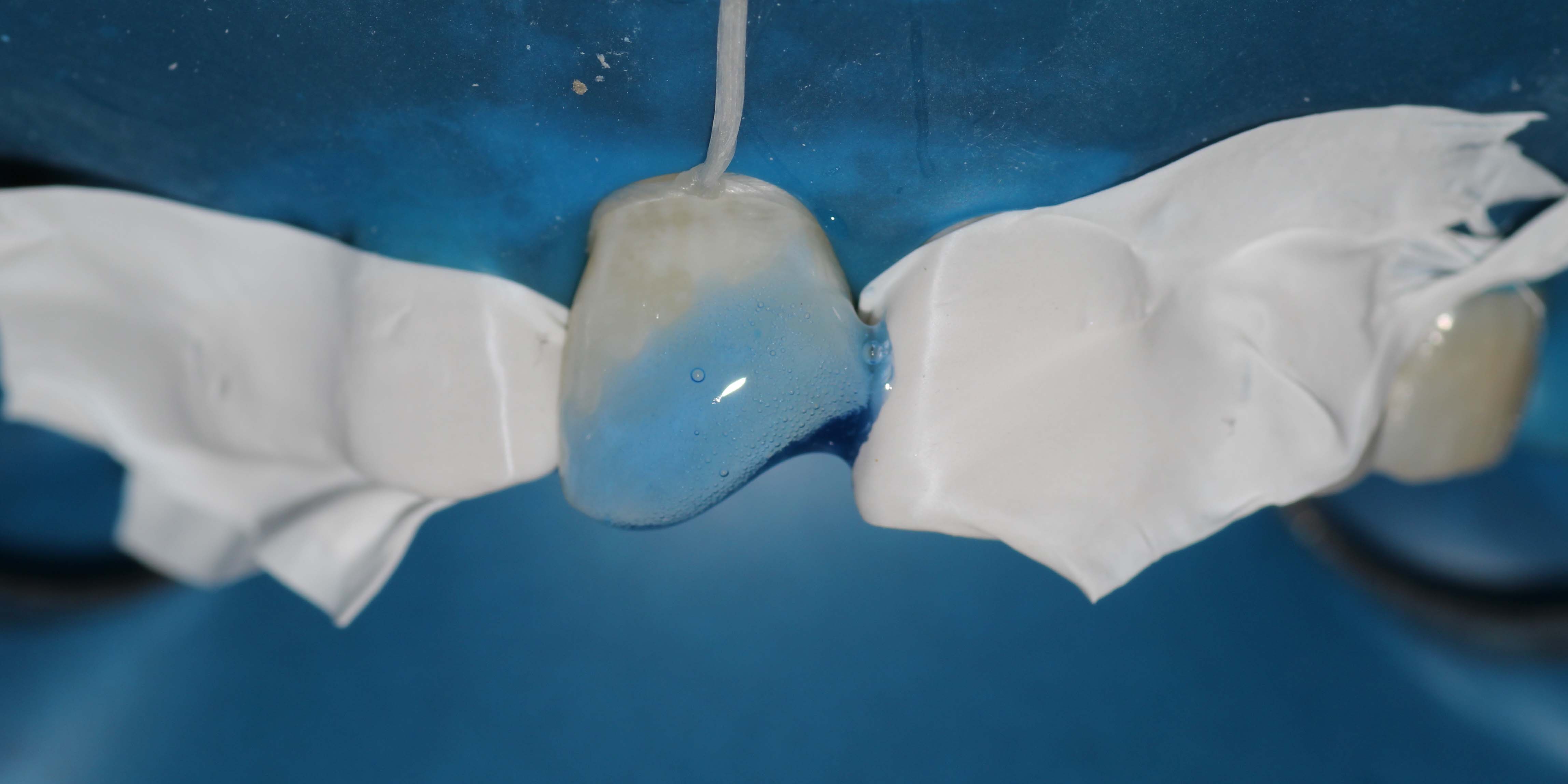 DT News - India - Developing tight proximal contacts in anterior teeth ...