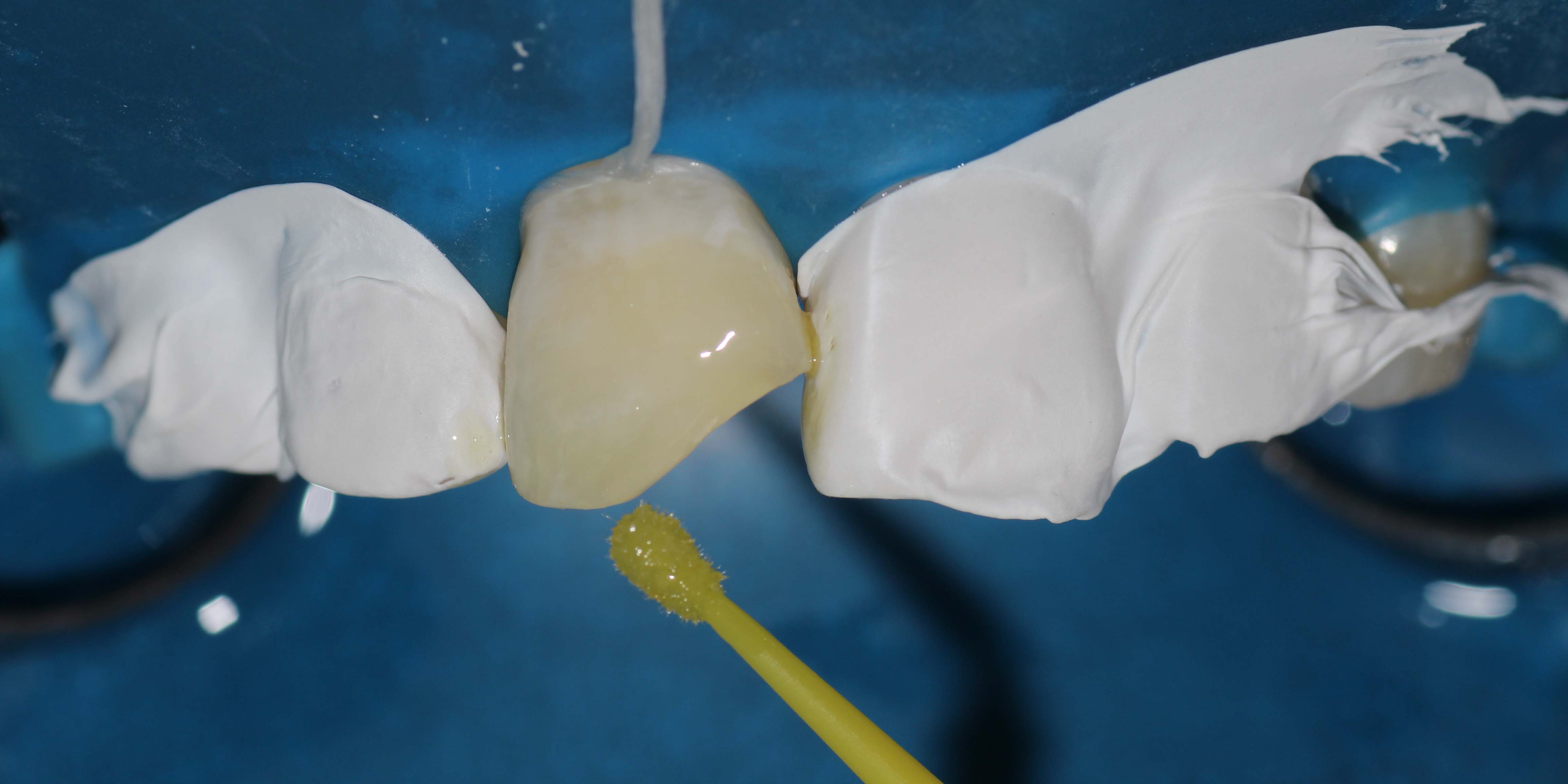 Developing tight proximal contacts in anterior teeth using Unica ...