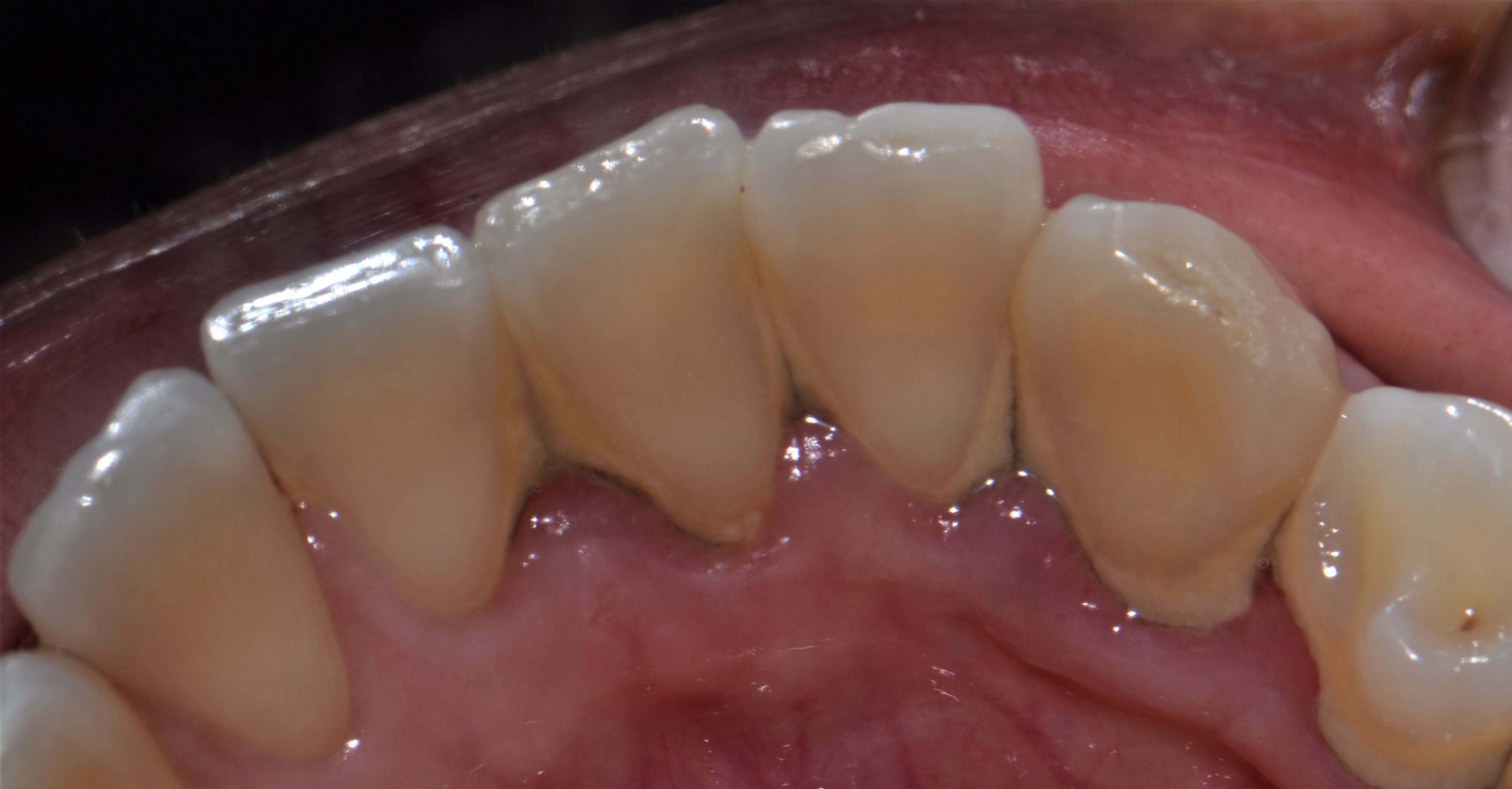 DT News - India - A Clinical Observation: Relation Between Dental ...