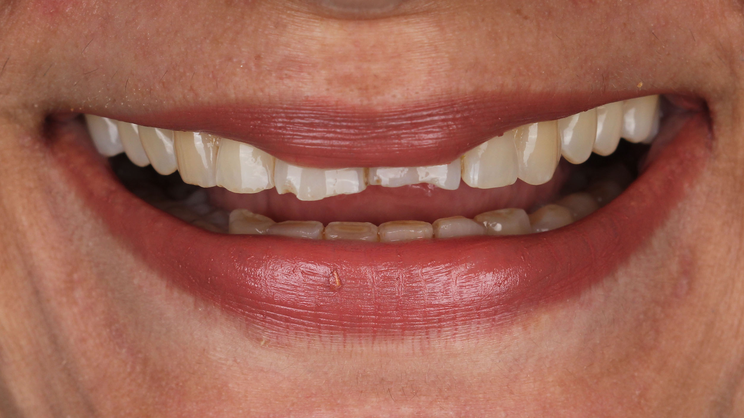 DT News - India - Correction of a Reverse Smile Line – Turning back the ...