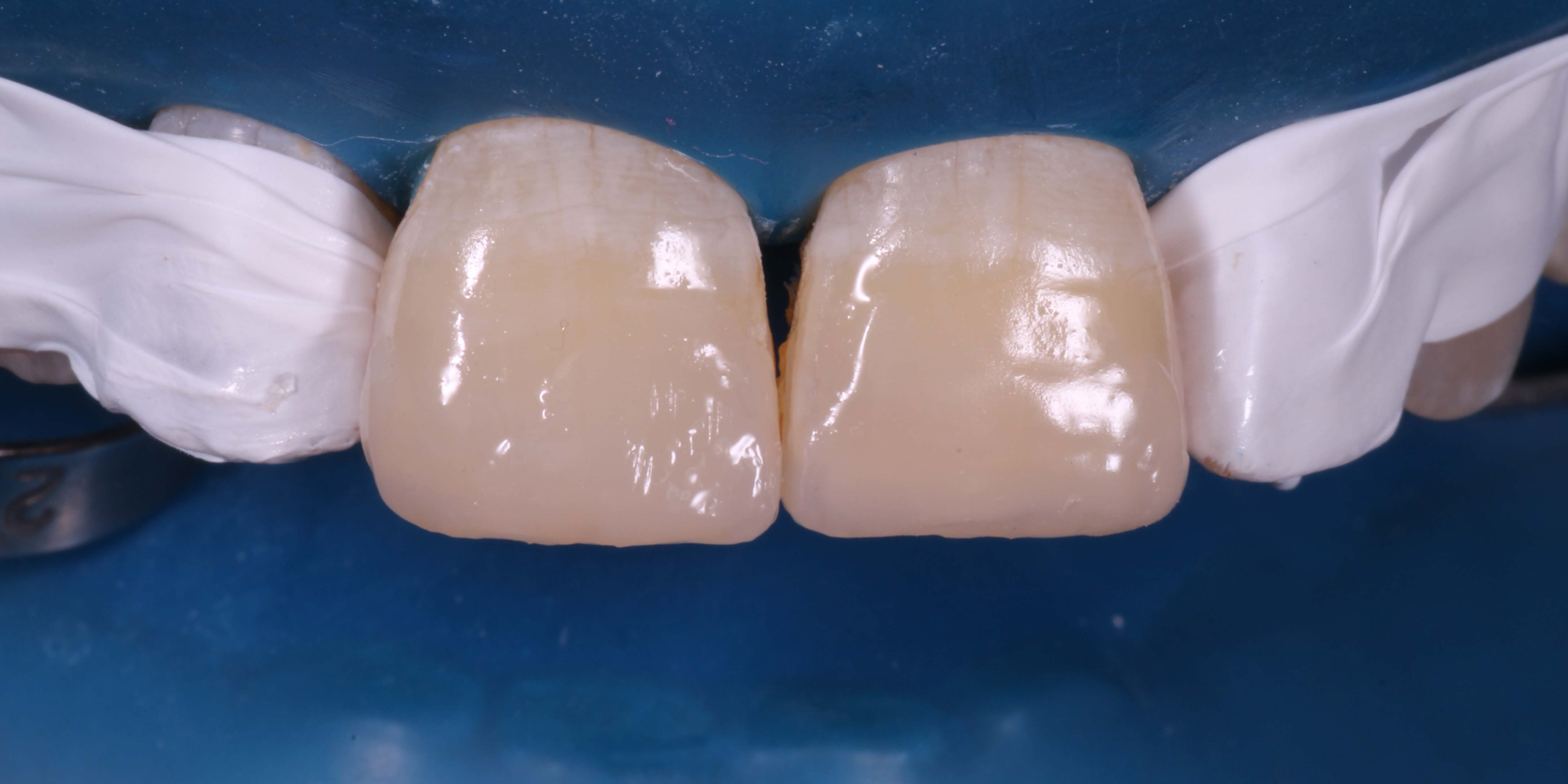 Correction of a Reverse Smile Line – Turning back the clock!