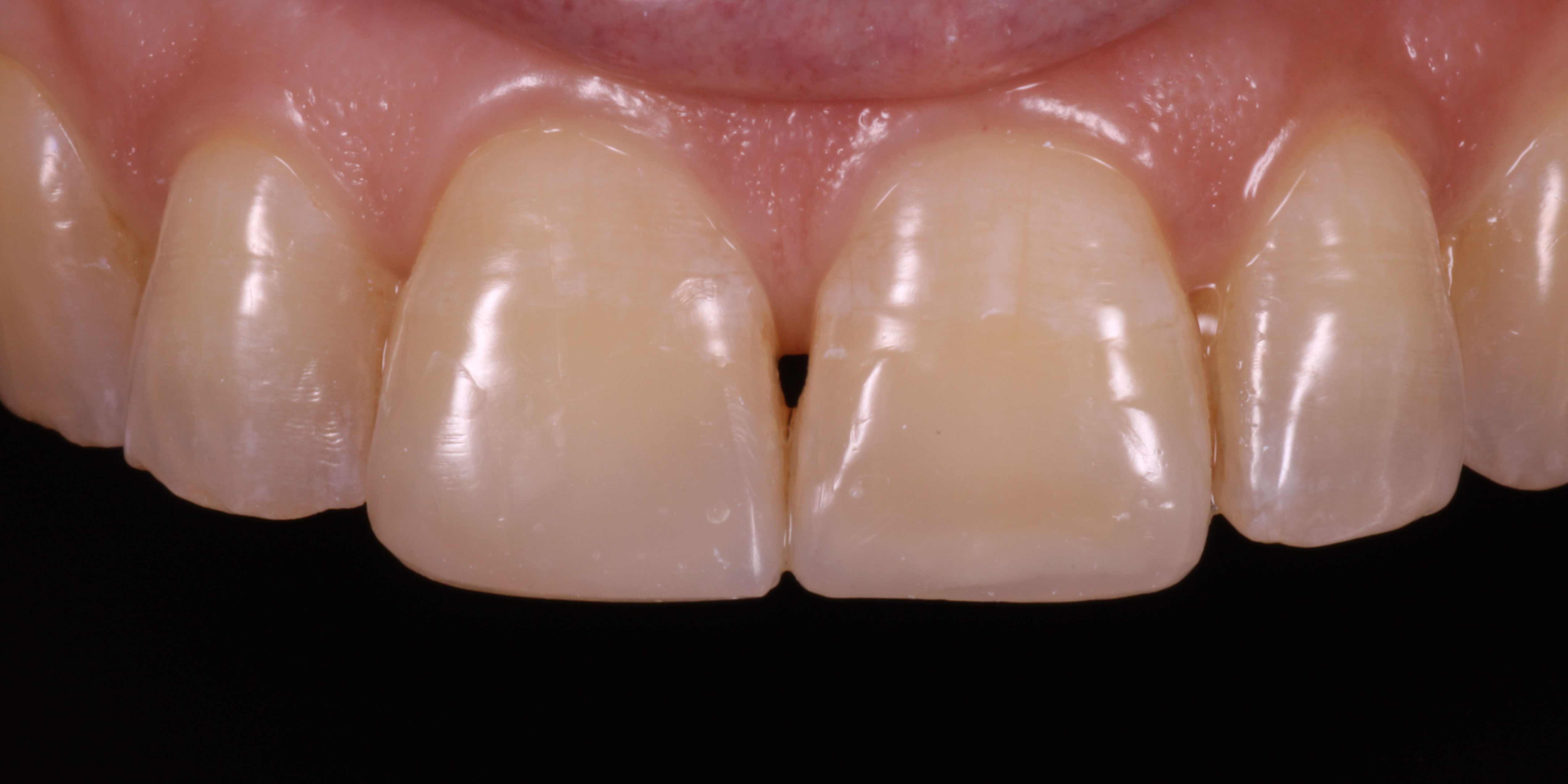 Correction of a Reverse Smile Line – Turning back the clock!