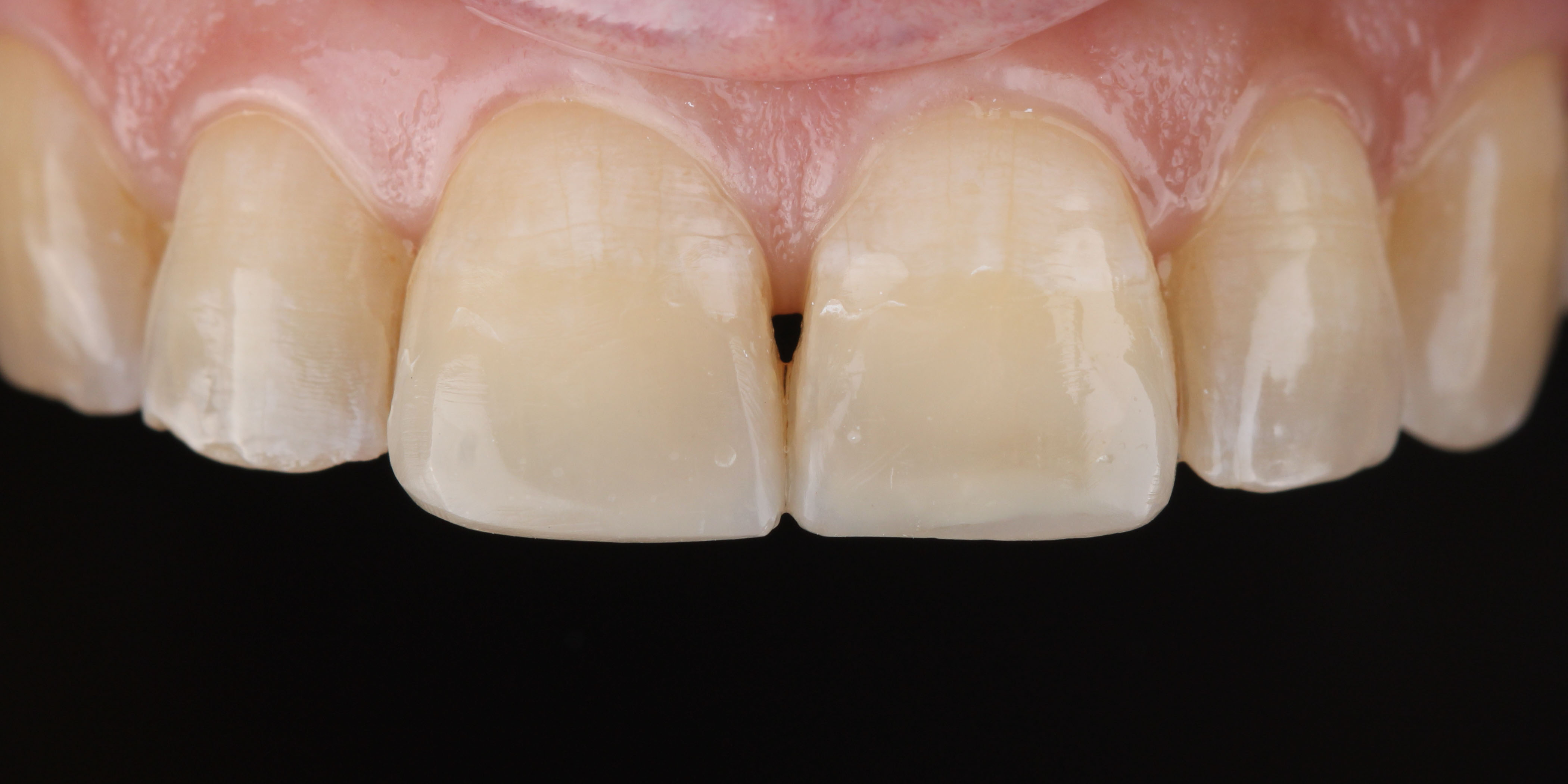 Correction of a Reverse Smile Line – Turning back the clock!