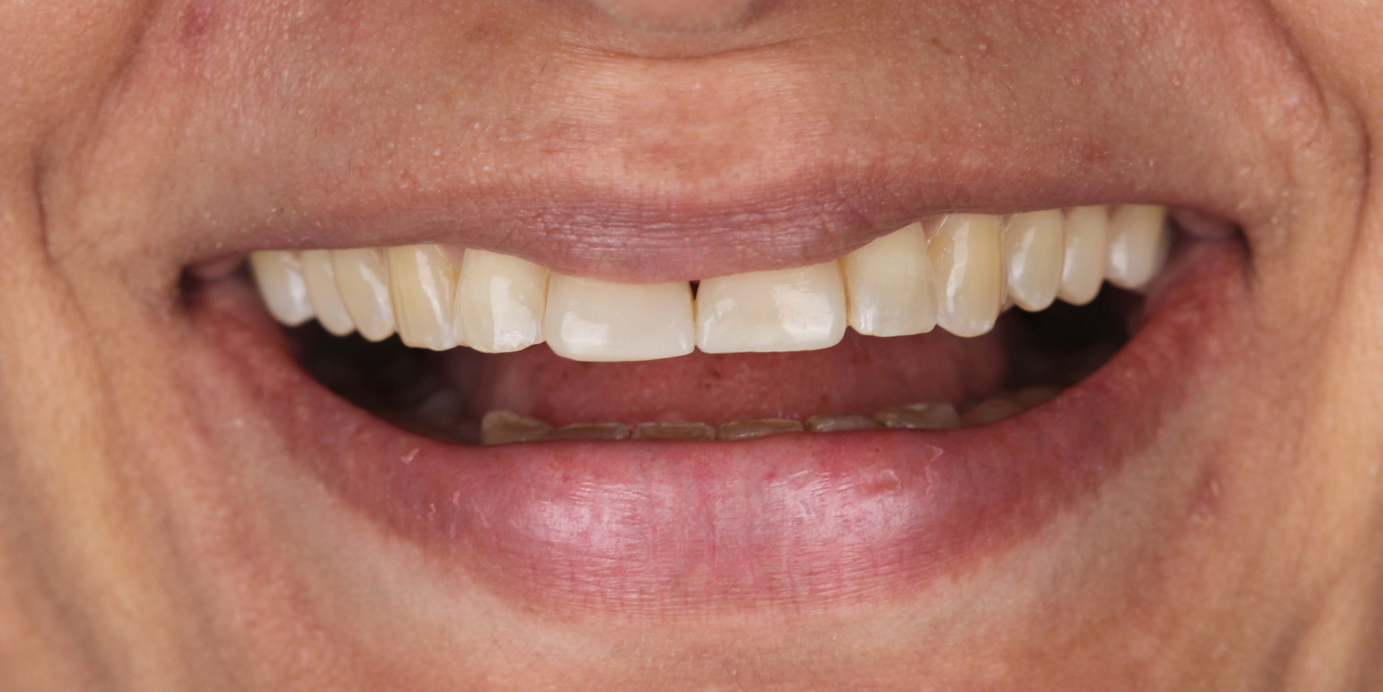 Correction of a Reverse Smile Line – Turning back the clock!
