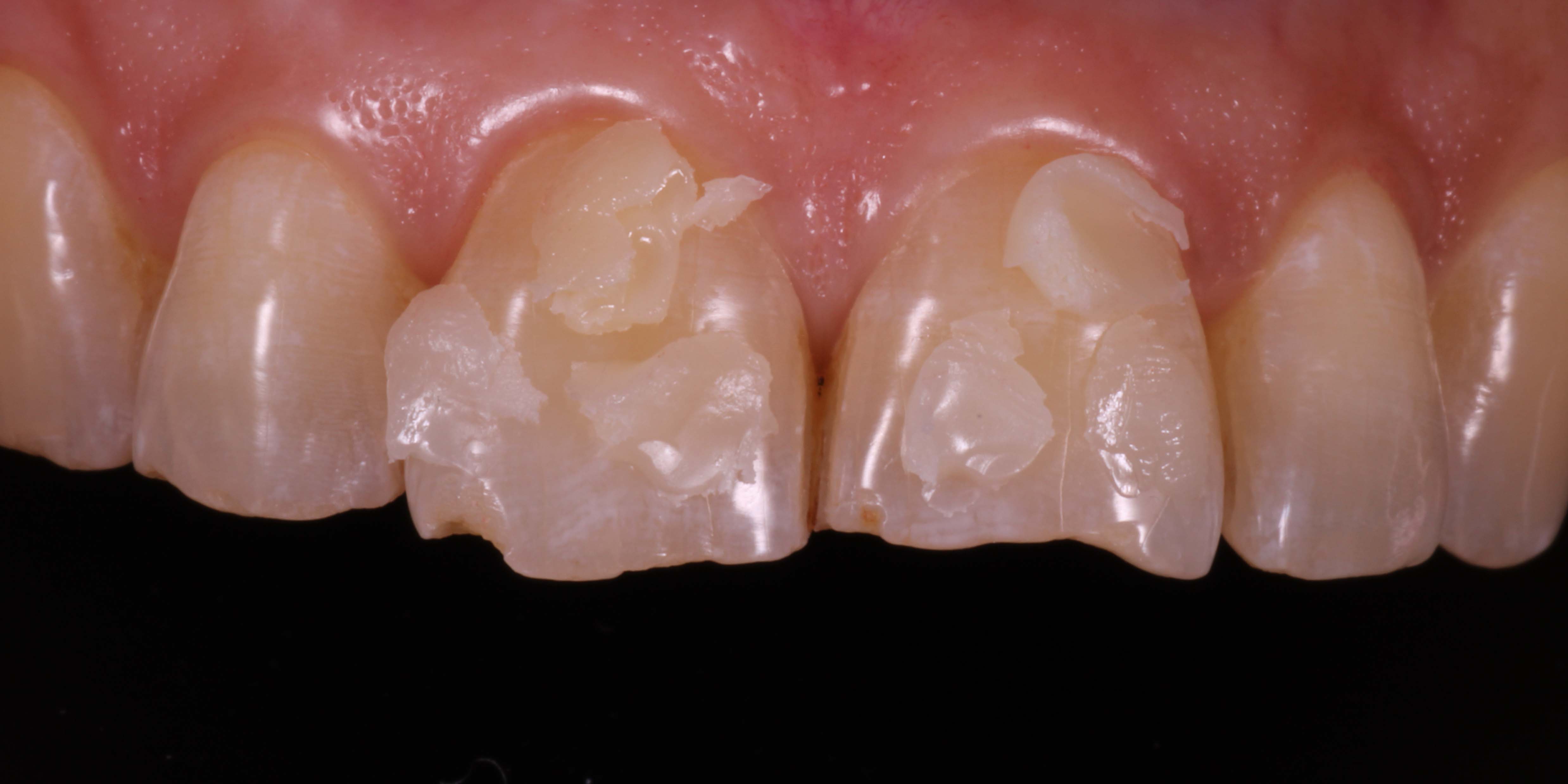 Correction of a Reverse Smile Line – Turning back the clock!