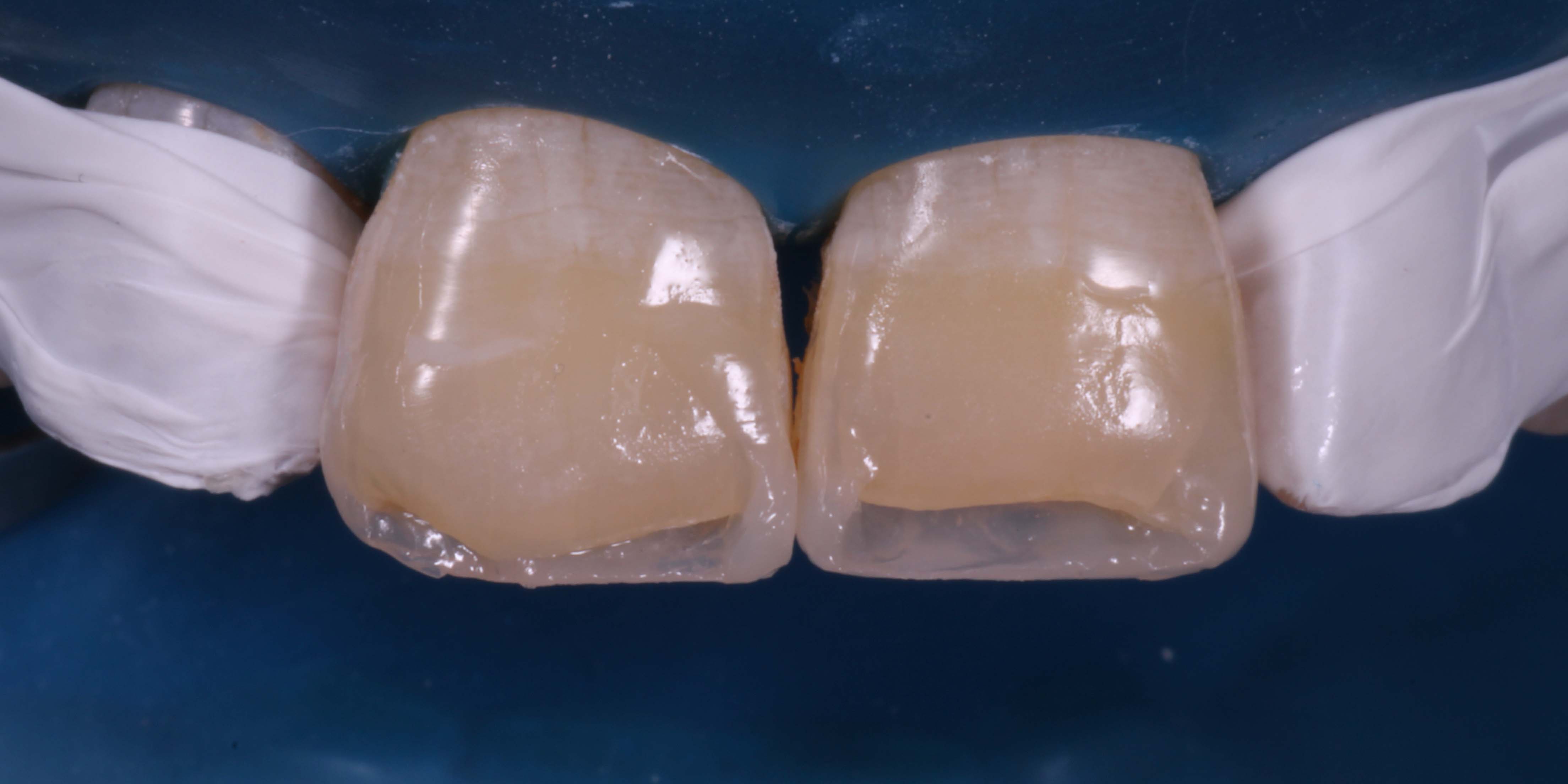 Correction of a Reverse Smile Line – Turning back the clock!