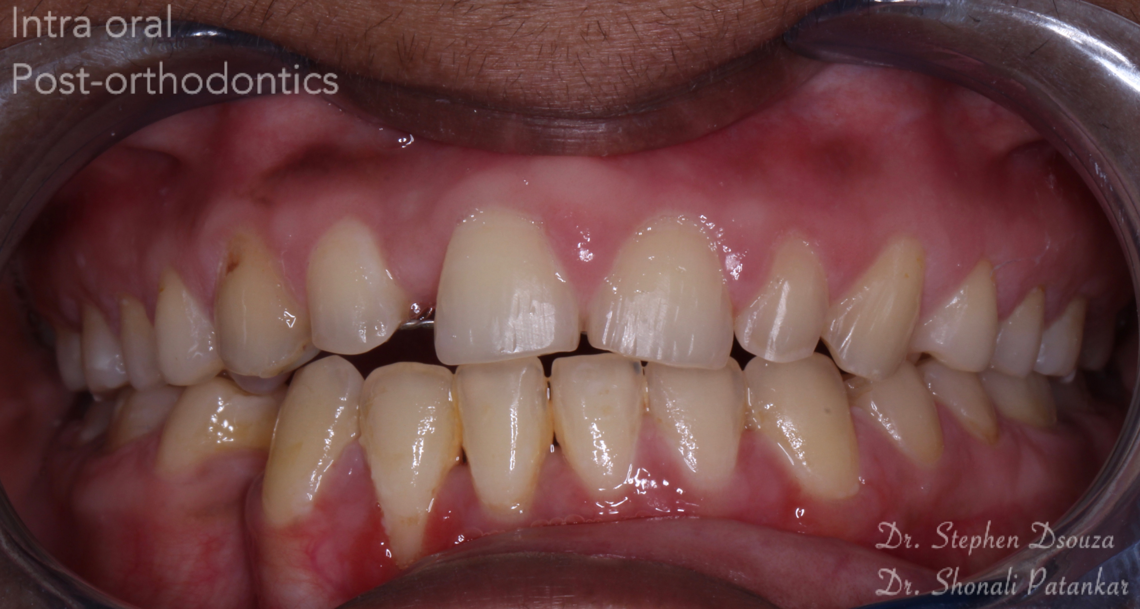 A minimally invasive smile makeover: an orthodontic-restorative approach.