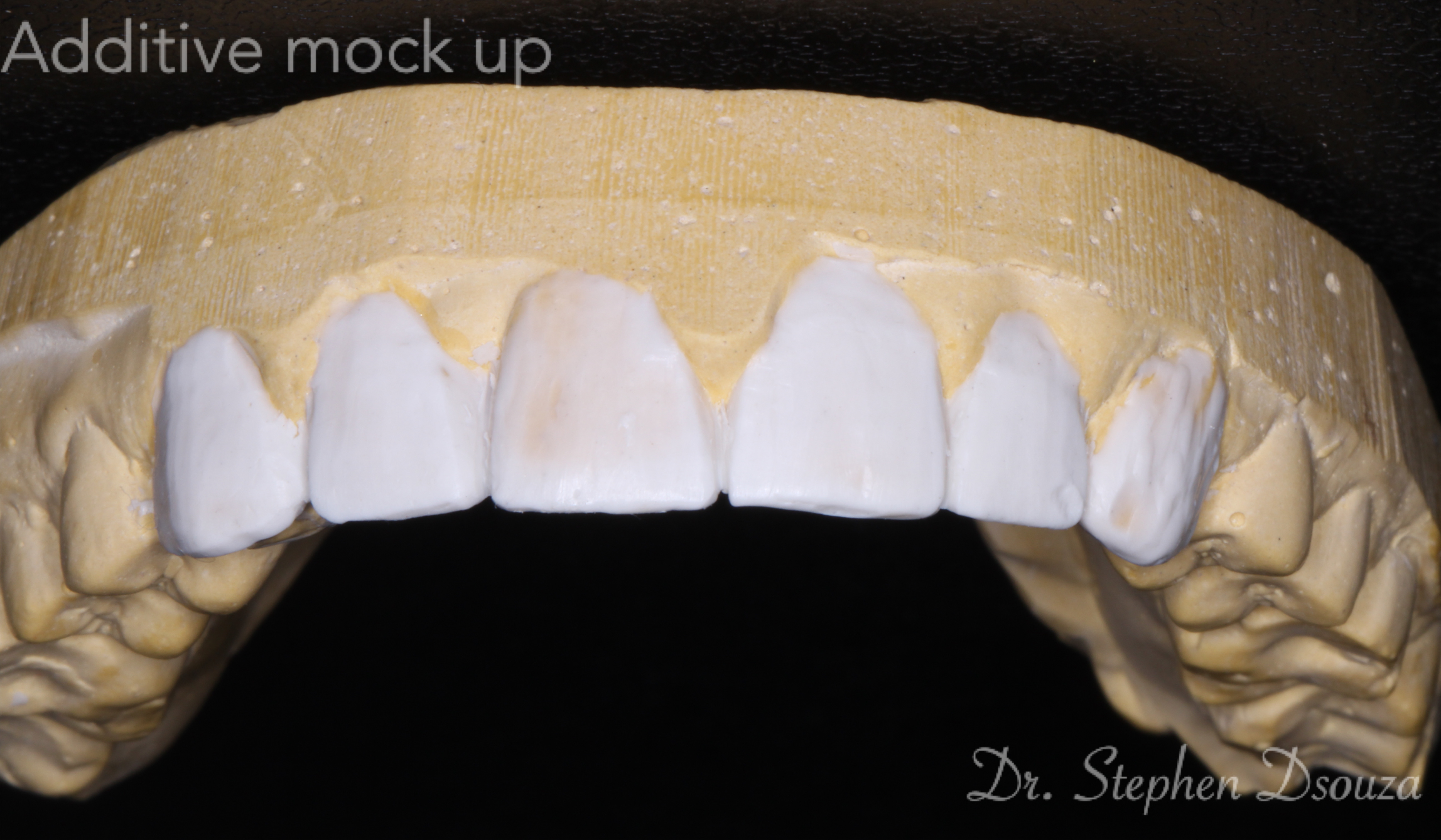 DT News - India - A minimally invasive smile makeover: an orthodontic ...