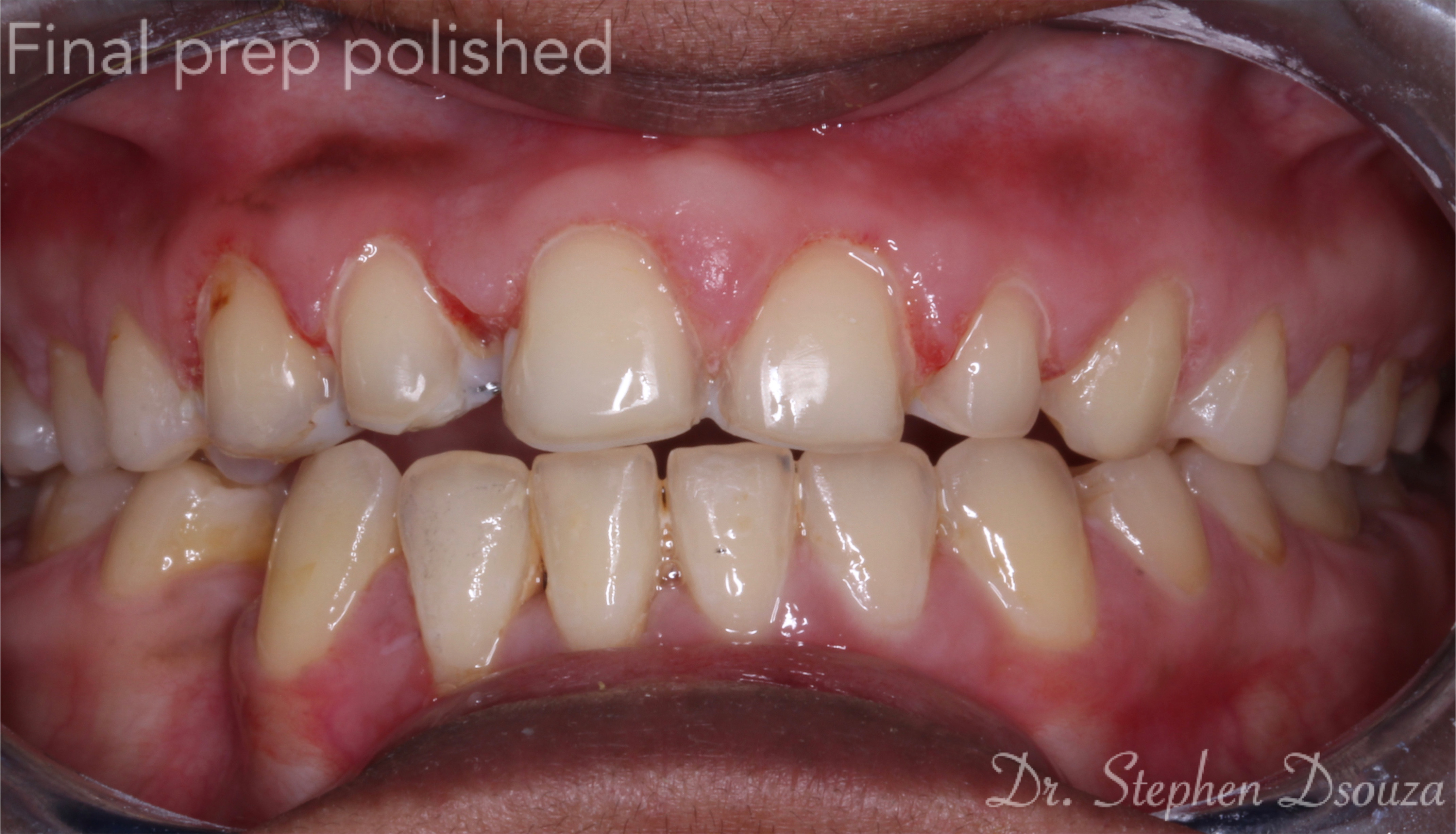 A minimally invasive smile makeover: an orthodontic-restorative approach.