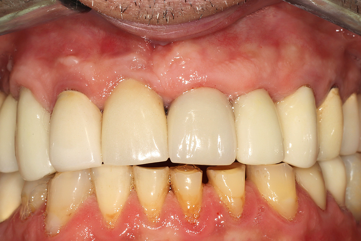 Dental News - Guided applications for partial extraction therapy