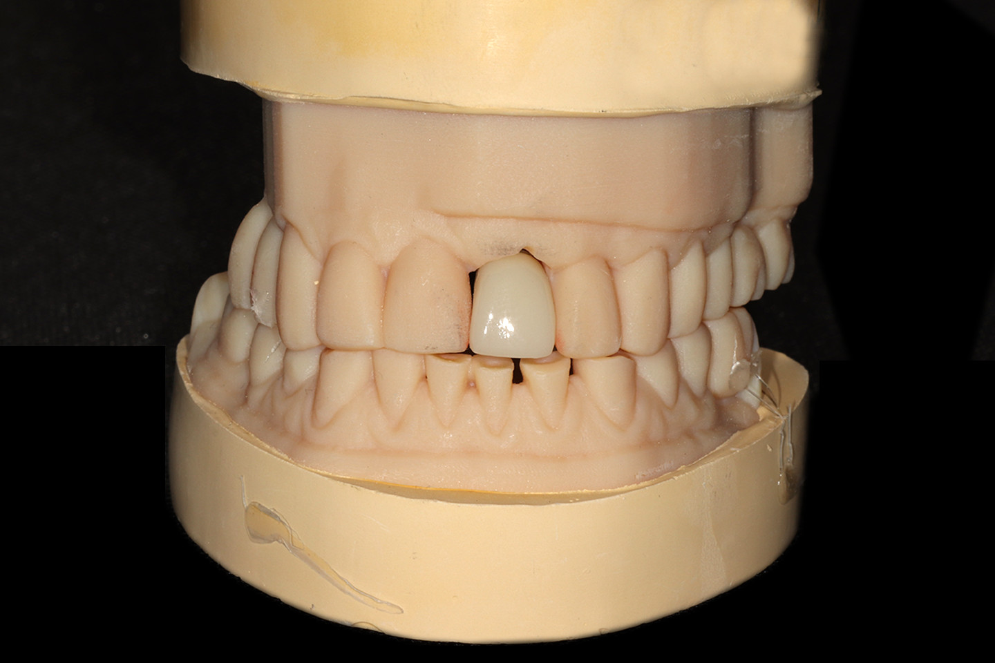 Dental News - Guided applications for partial extraction therapy