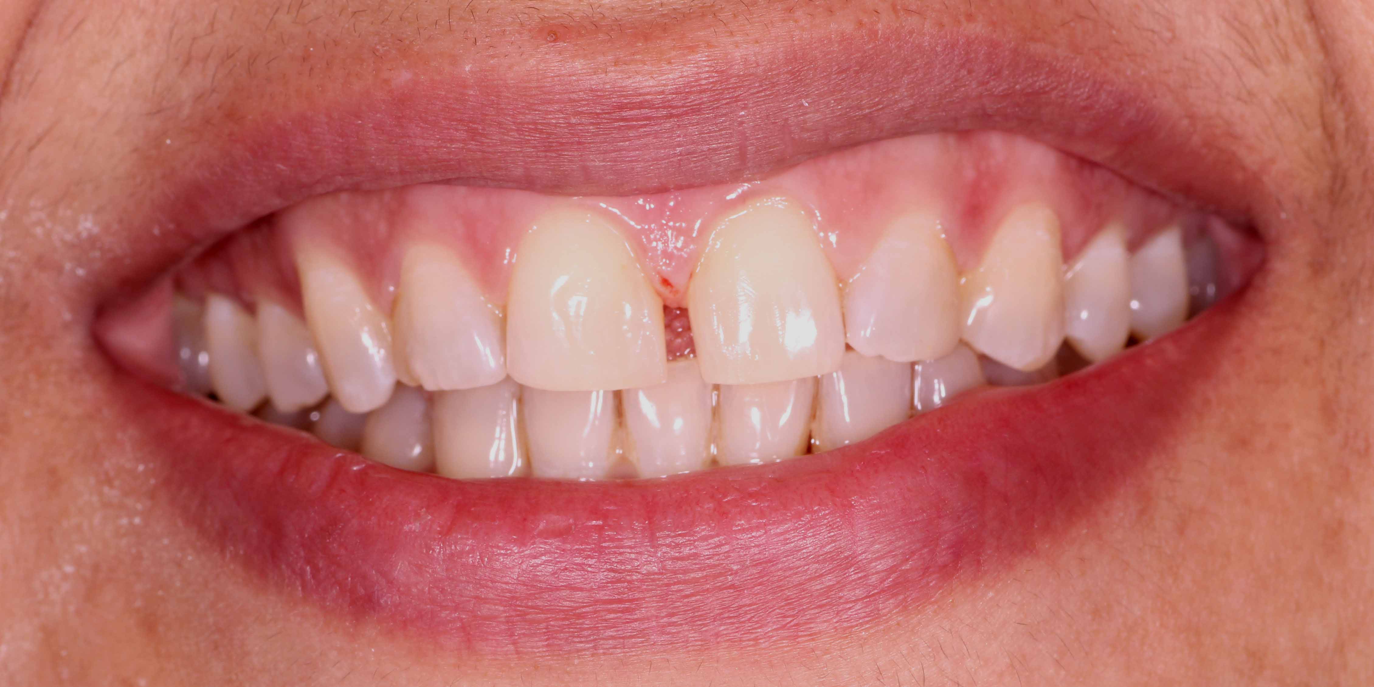 Front wing technique for direct diastema closures - Dr. Nisha Deshpande