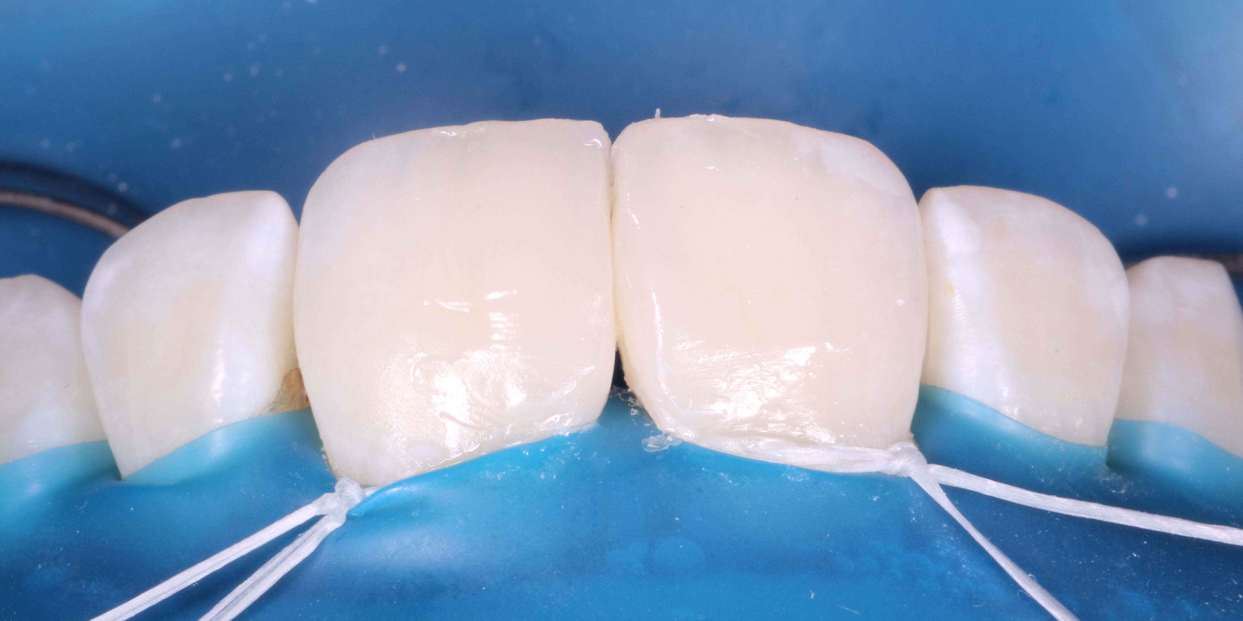 Front wing technique for direct diastema closures - Dr. Nisha Deshpande