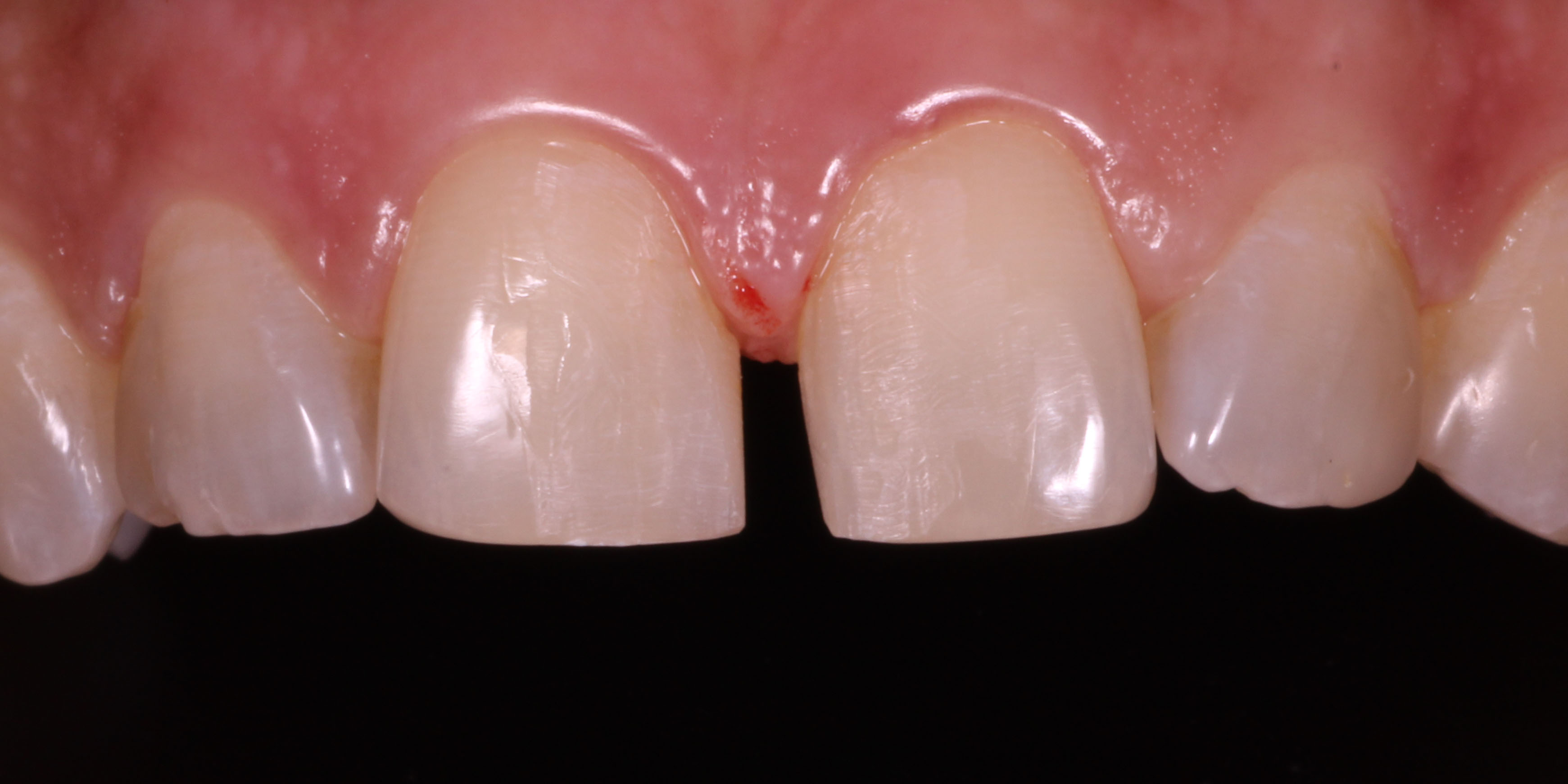 Front wing technique for direct diastema closures - Dr. Nisha Deshpande