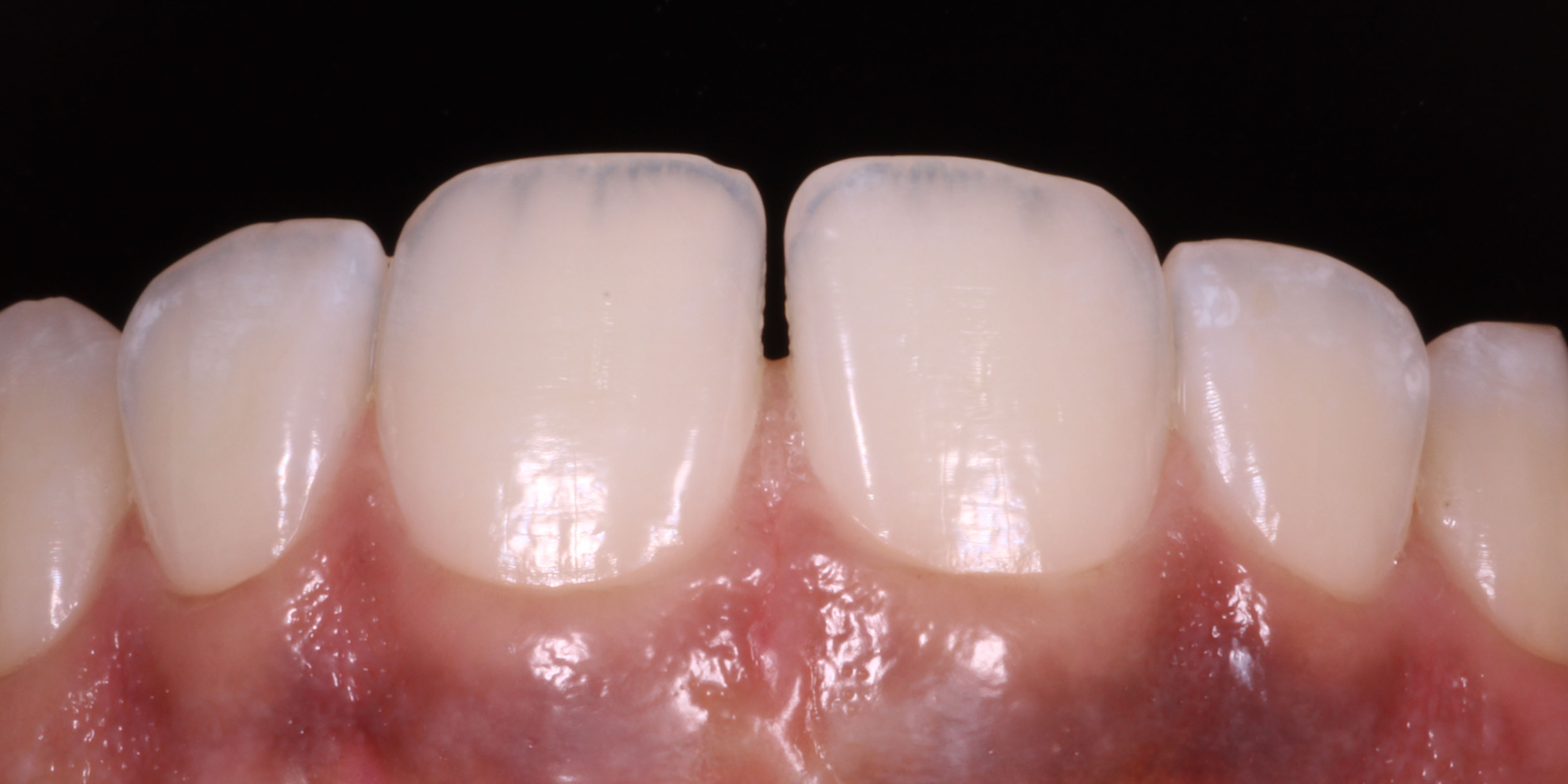 DT News - India - Front wing technique for direct diastema closures ...