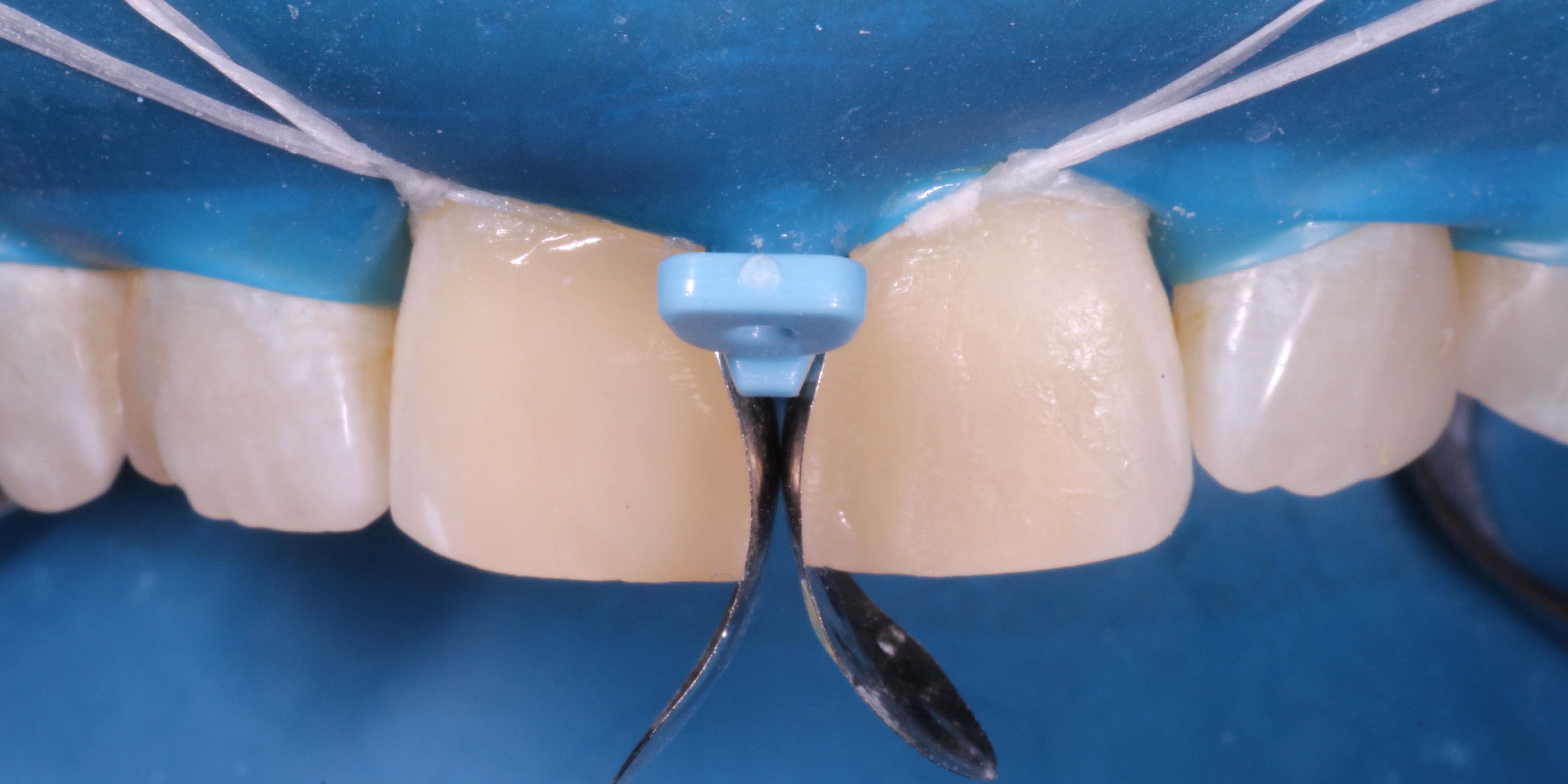 Front wing technique for direct diastema closures - Dr. Nisha Deshpande