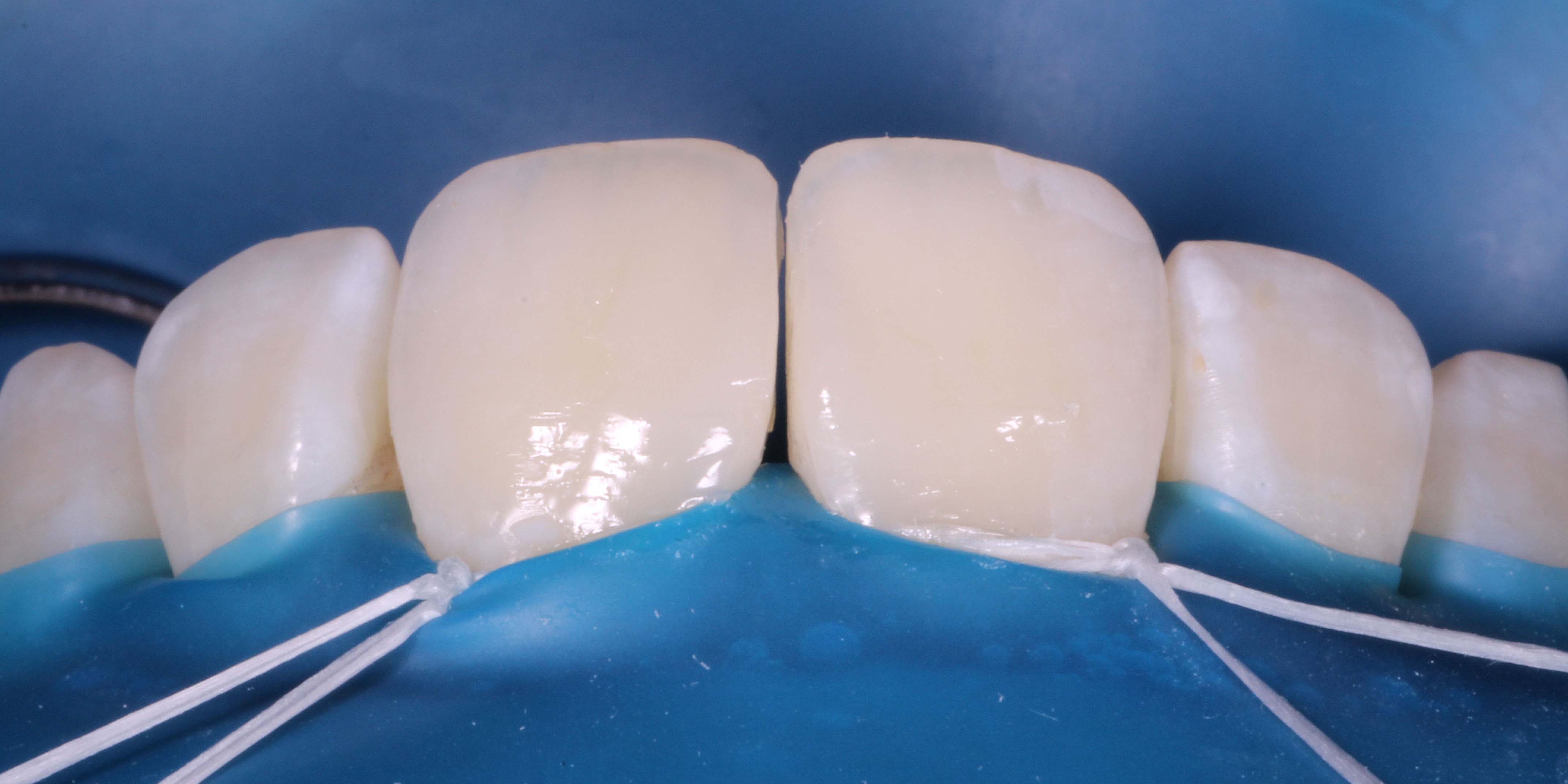 Front wing technique for direct diastema closures - Dr. Nisha Deshpande