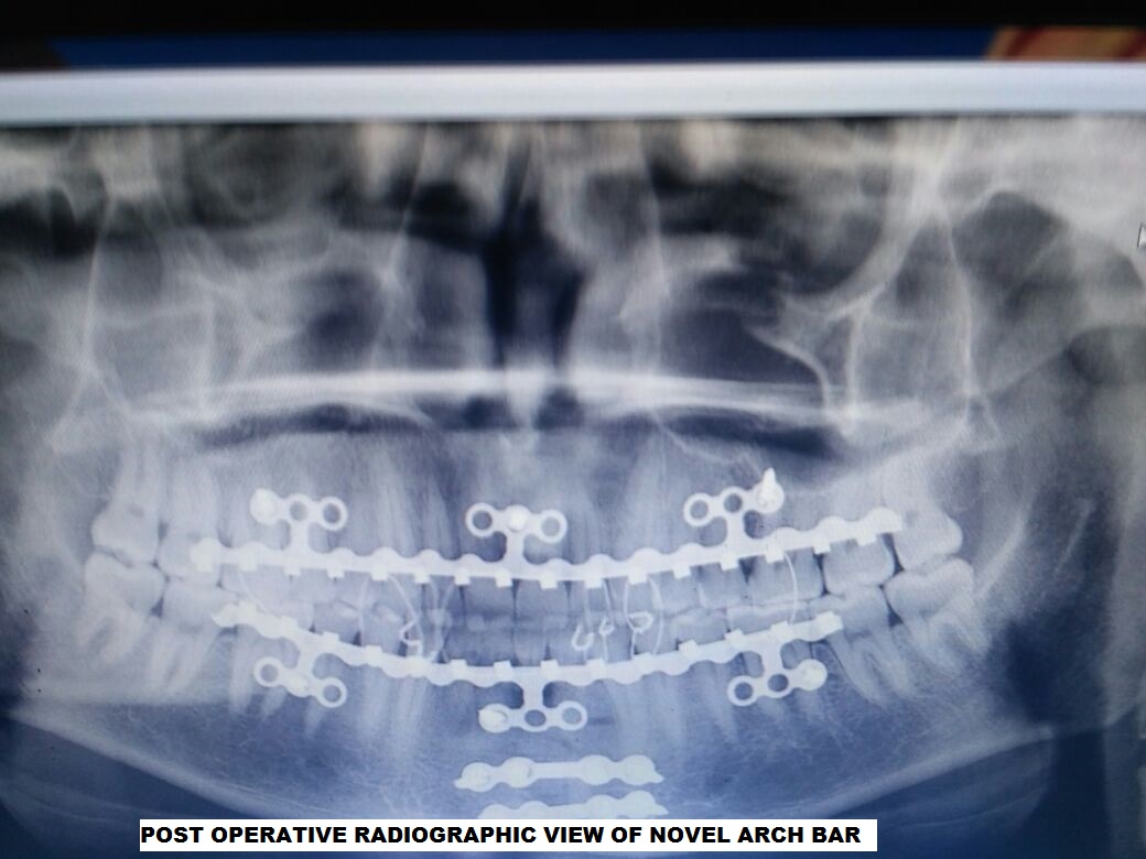 "Novel Arch Bar" patent by Dr. Soumendu Karak, OMFS