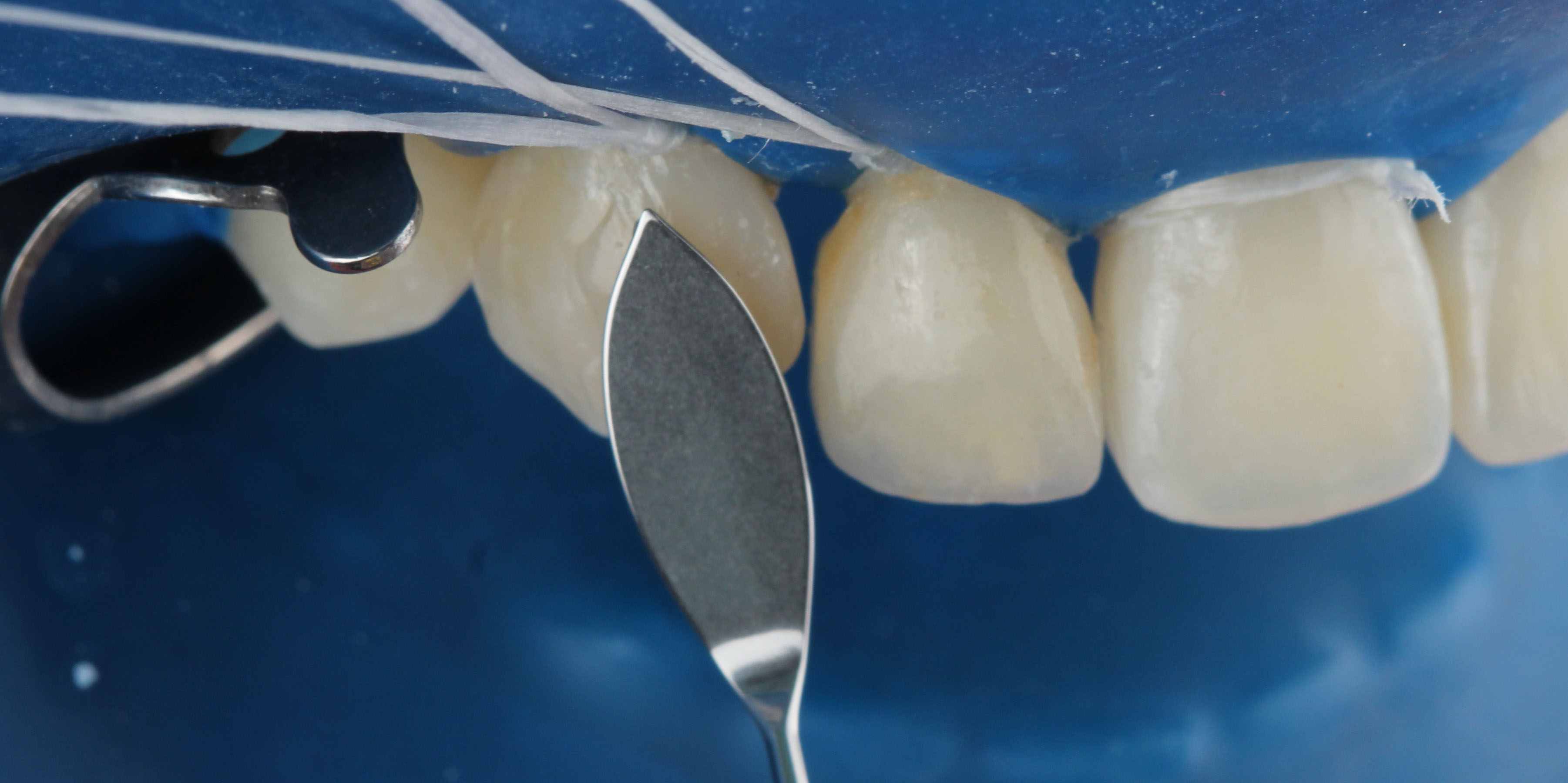 DT News - India - LM Arte Solo Anterior Composite Sculpting Instrument ...