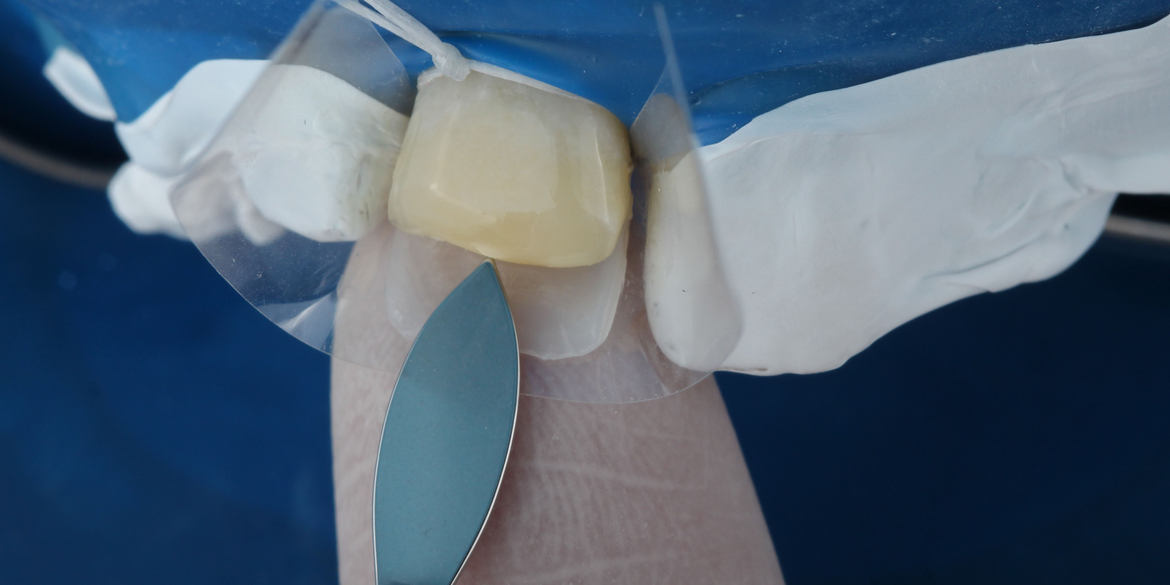 DT News - India - LM Arte Solo Anterior Composite Sculpting Instrument ...