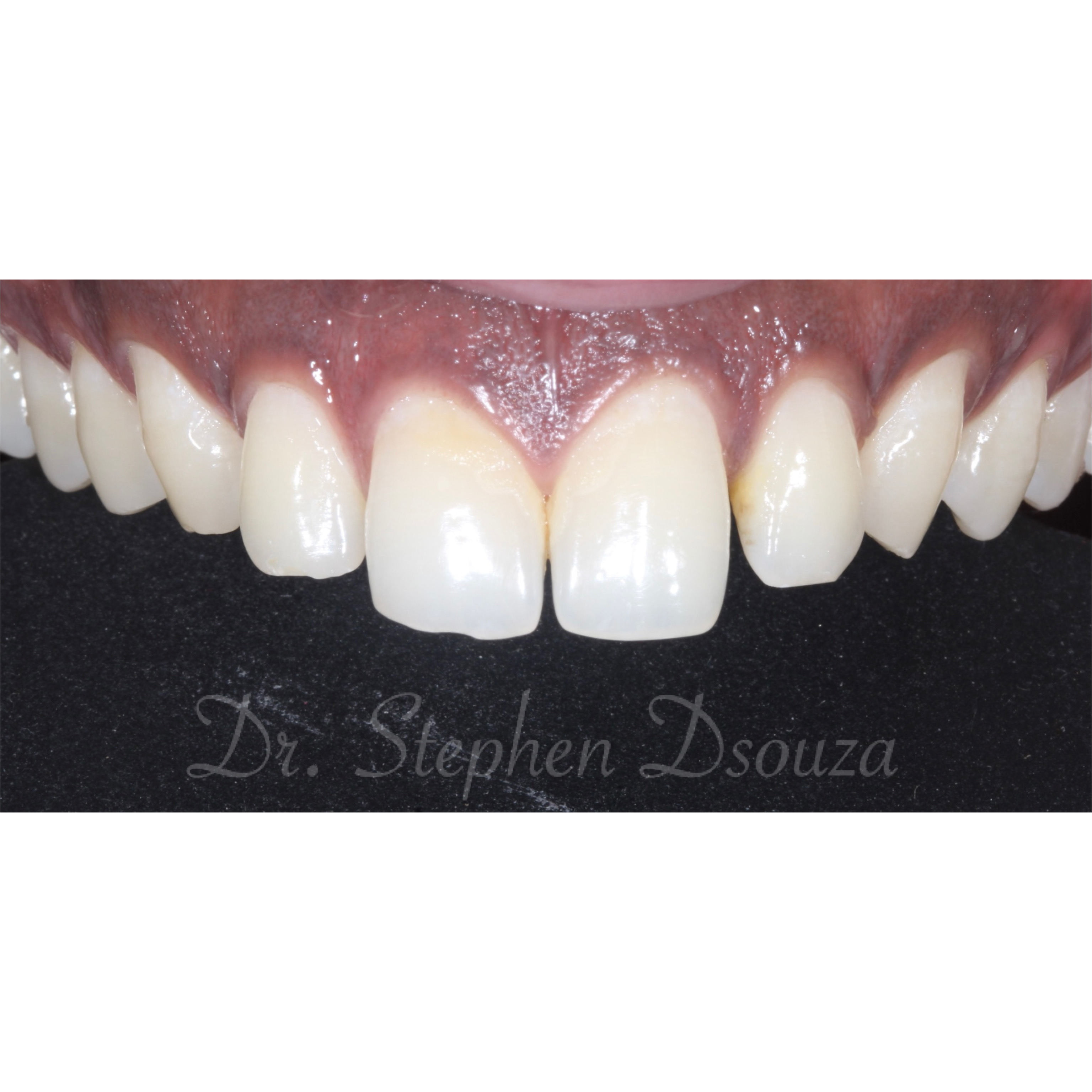 DT News - India - Smile makeover with composite veneers using injection ...