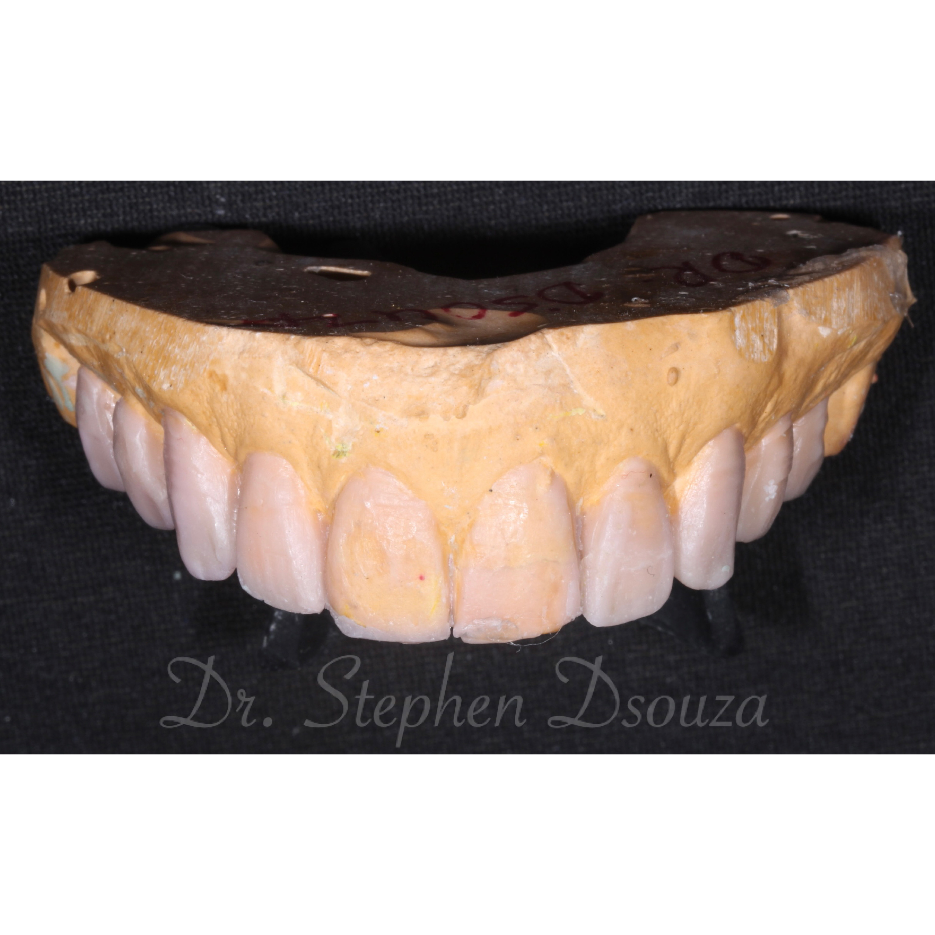 DT News - India - Smile makeover with composite veneers using injection ...