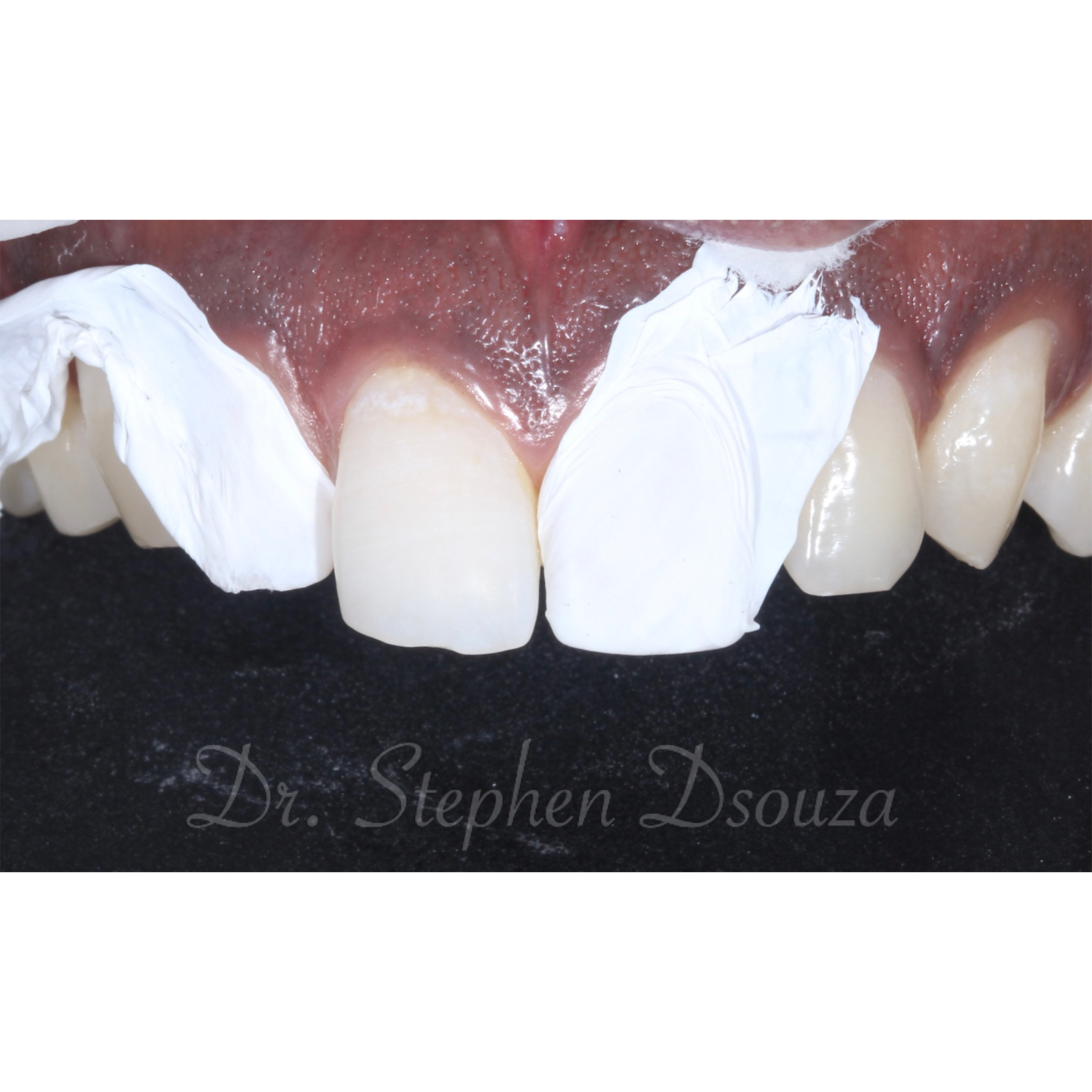 DT News - India - Smile makeover with composite veneers using injection ...
