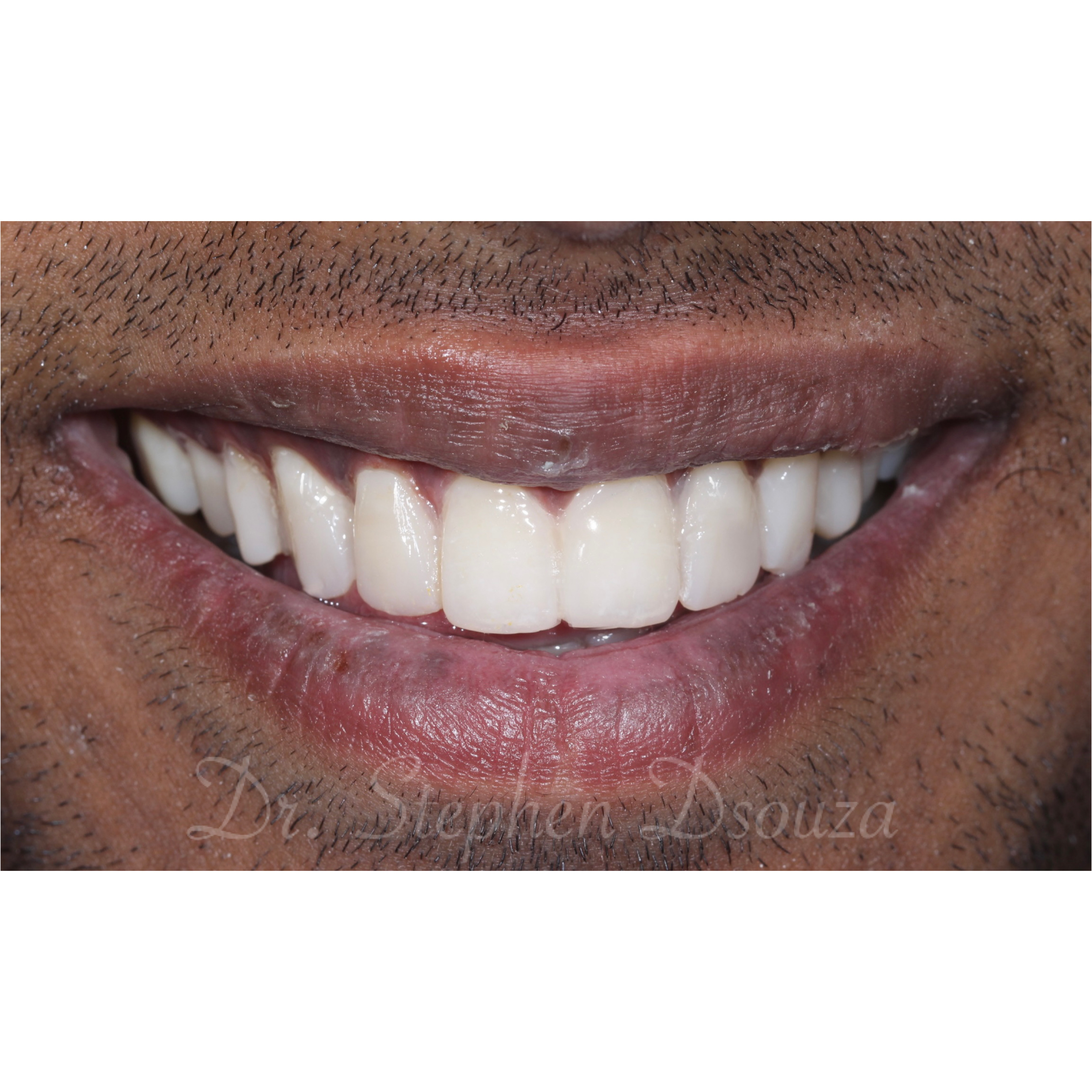 Smile makeover with composite veneers using injection moulding - Dr ...