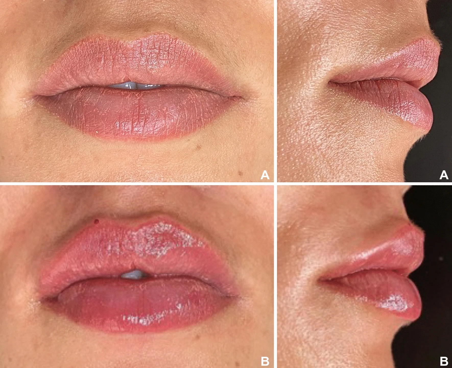 DT News - International - Hyaluronic acid fillers: Can fuller lips be ...