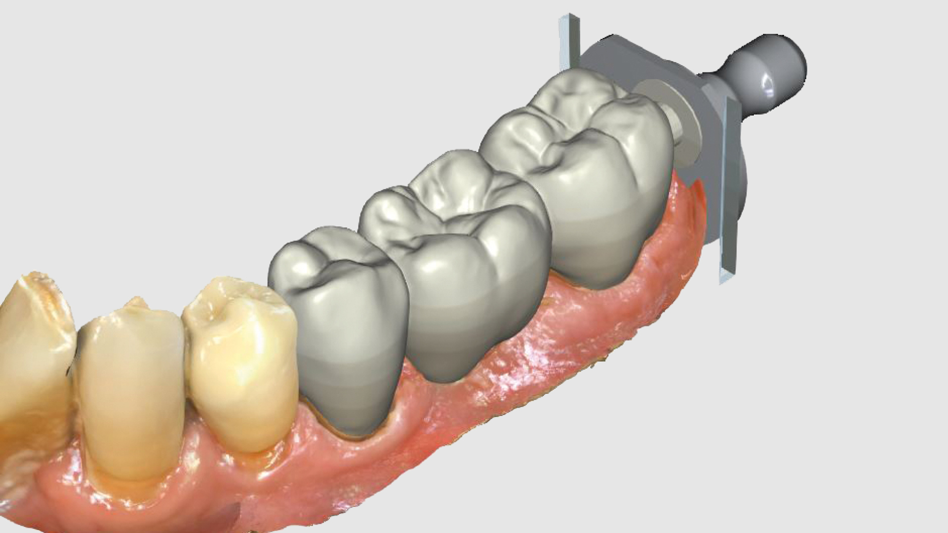 Dental News - Unilateral occlusal elevation with a lithium disilicate ...