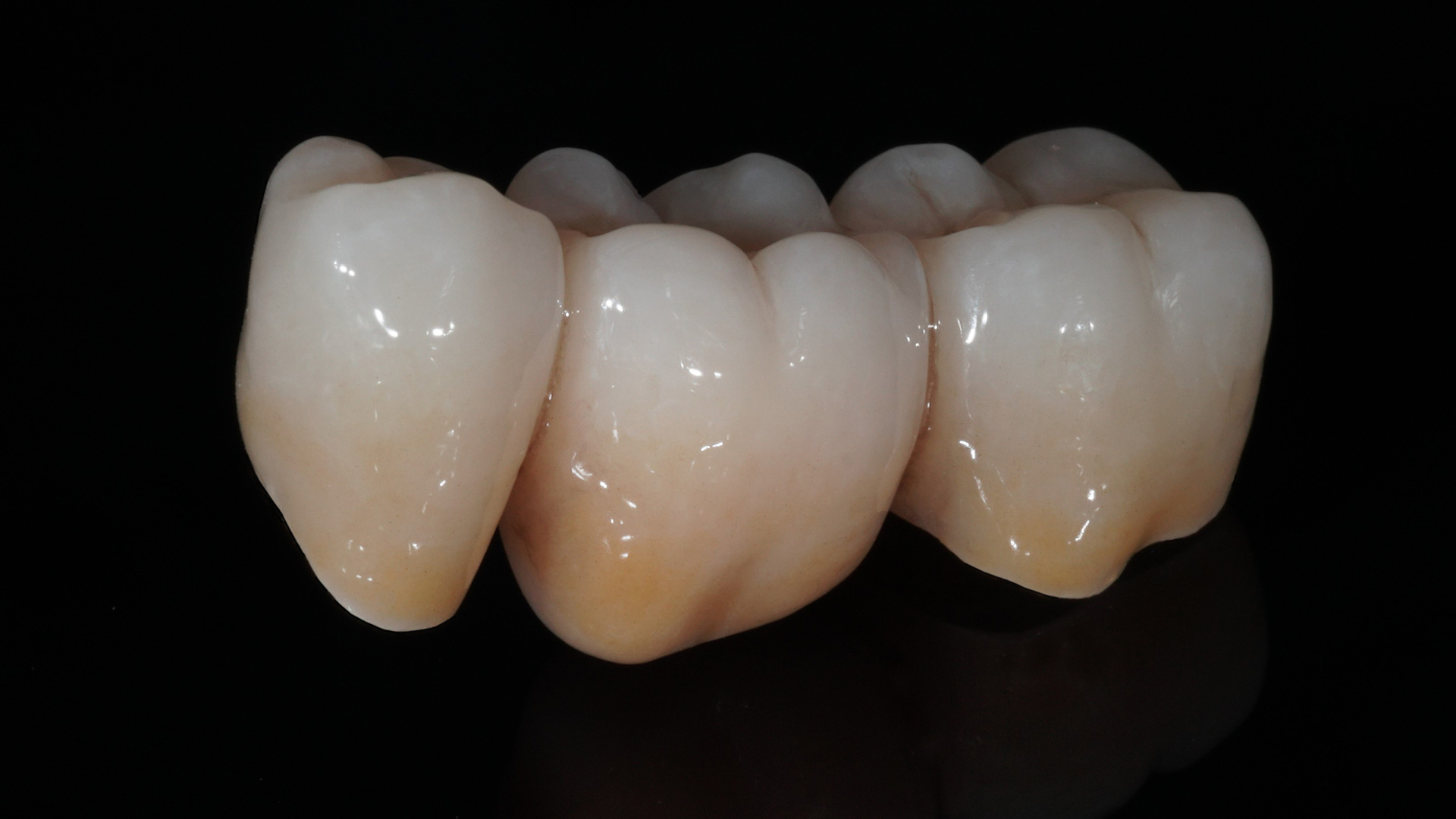 Dental News - Unilateral occlusal elevation with a lithium disilicate ...